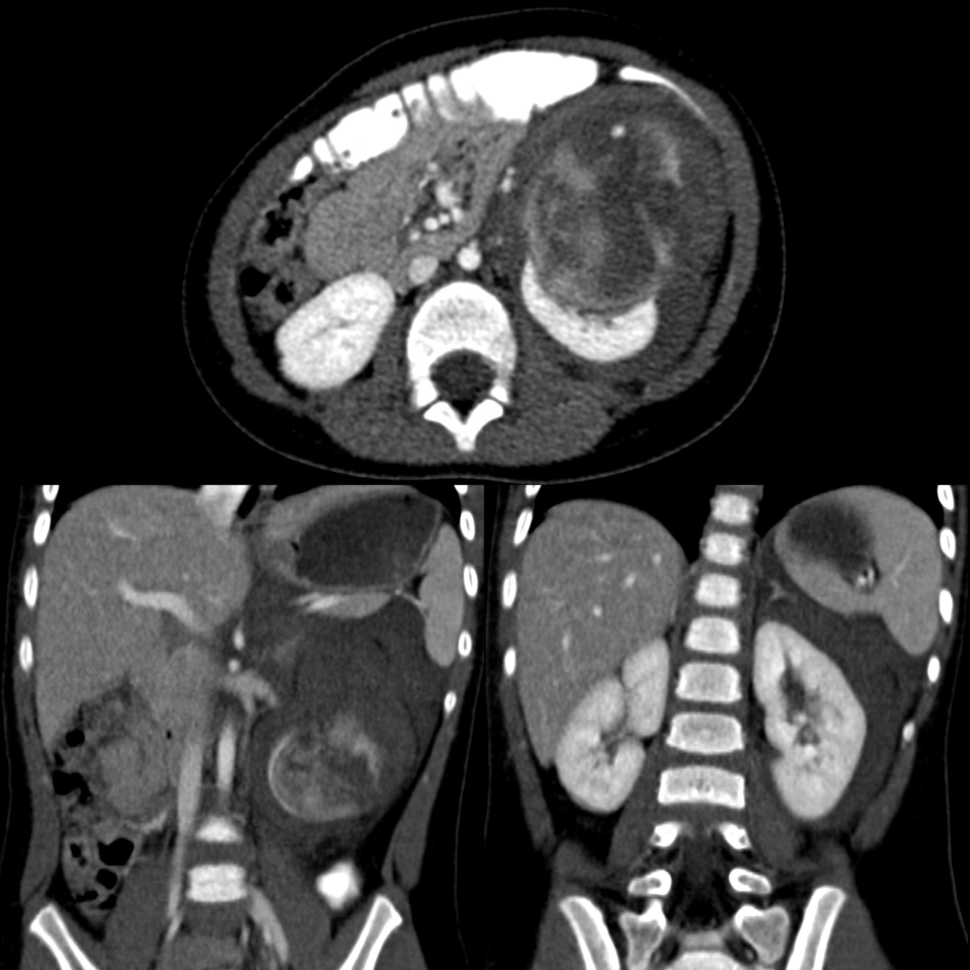 Pediatric Clear Cell Sarcoma of Kidney | Pediatric Radiology Reference ...