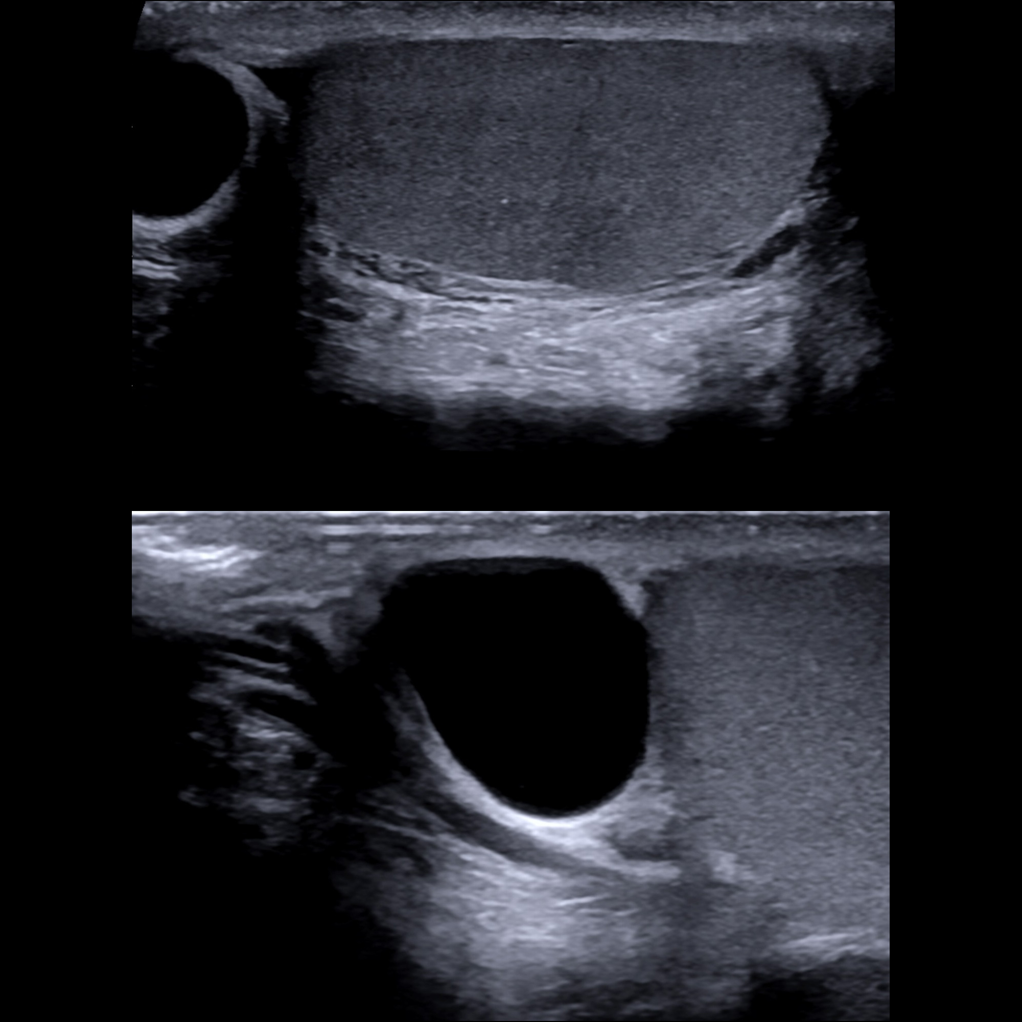 Epididymal Cyst Ultrasound