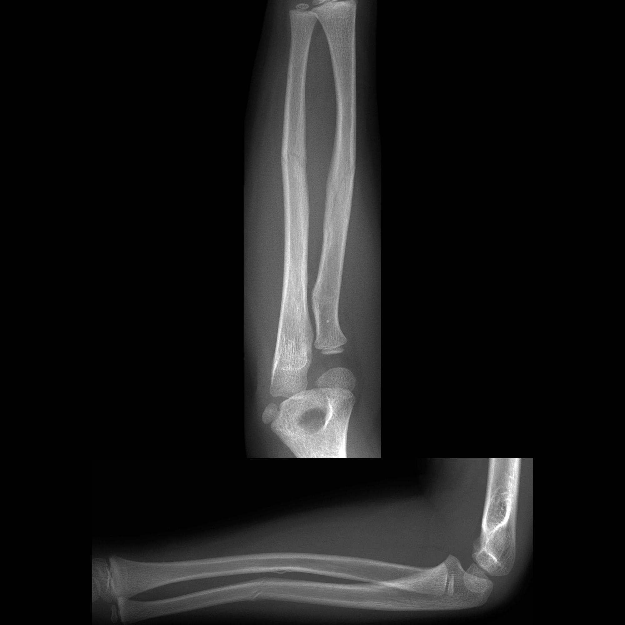 Pediatric Greenstick Fracture | Pediatric Radiology Reference Article ...