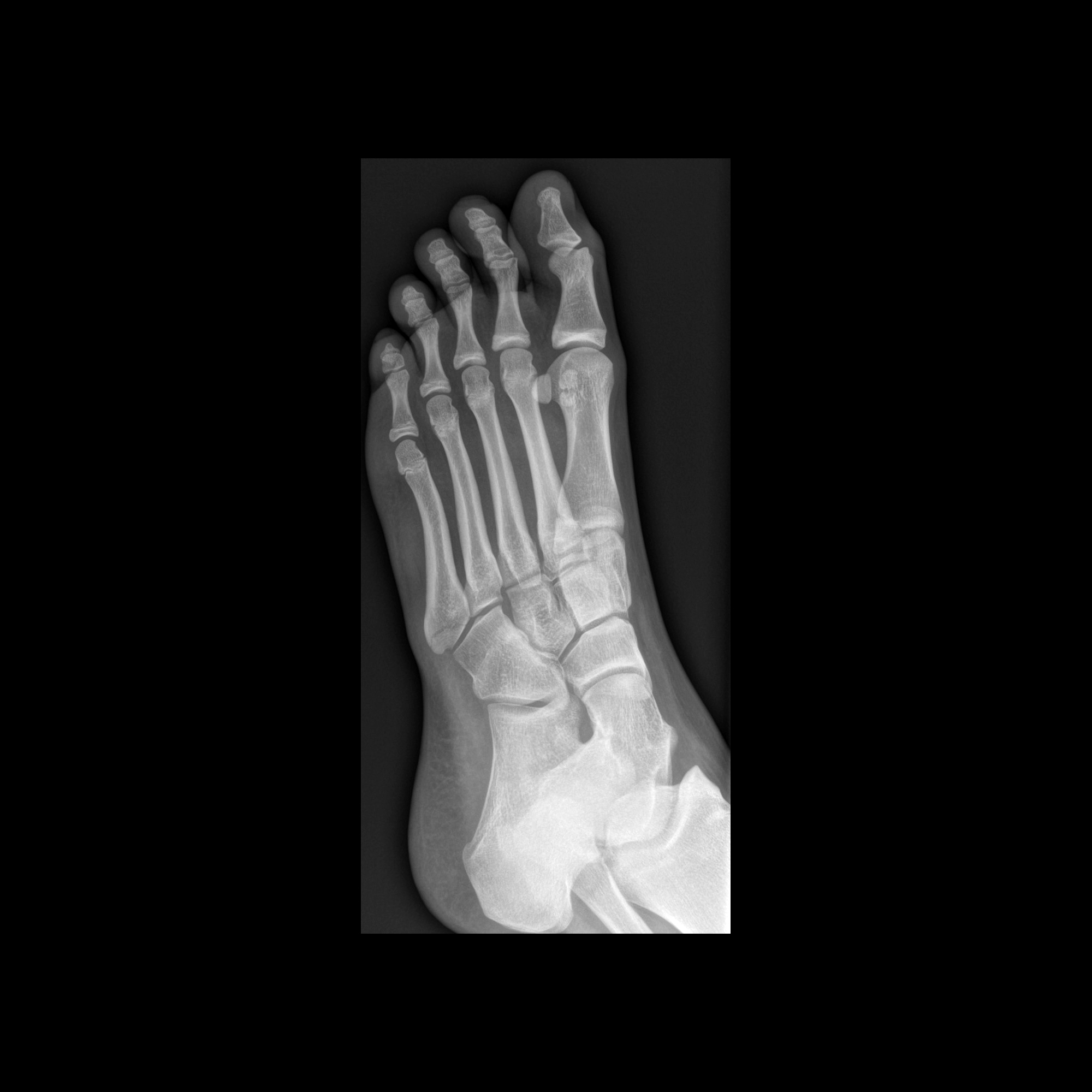 Pediatric Fifth Metatarsal Fracture | Pediatric Radiology Reference ...