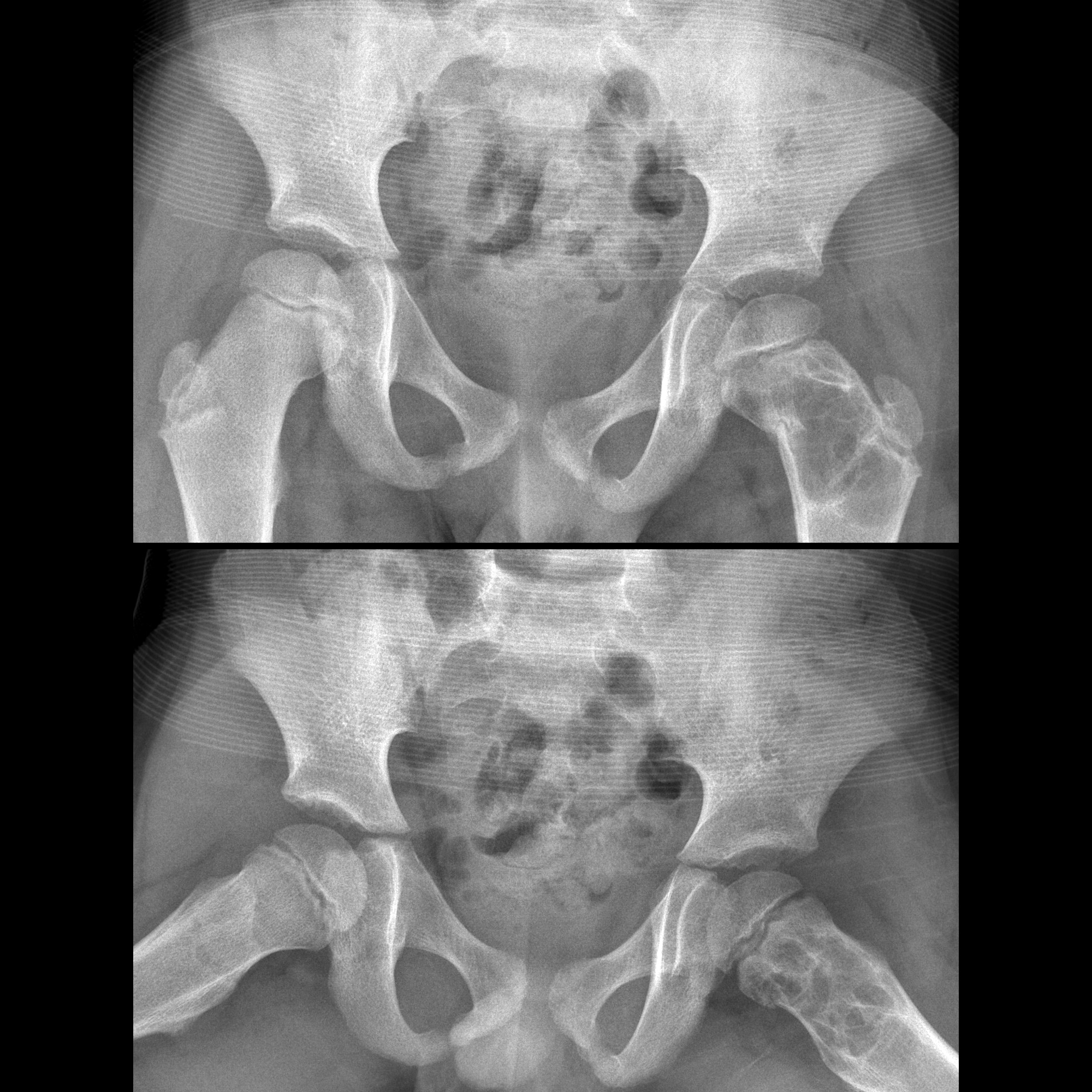 Pediatric Pathologic Fracture | Pediatric Radiology Reference Article ...