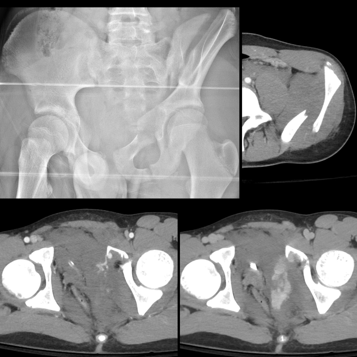 Teenager with left hip pain after trauma and a decreasing hemoglobin ...