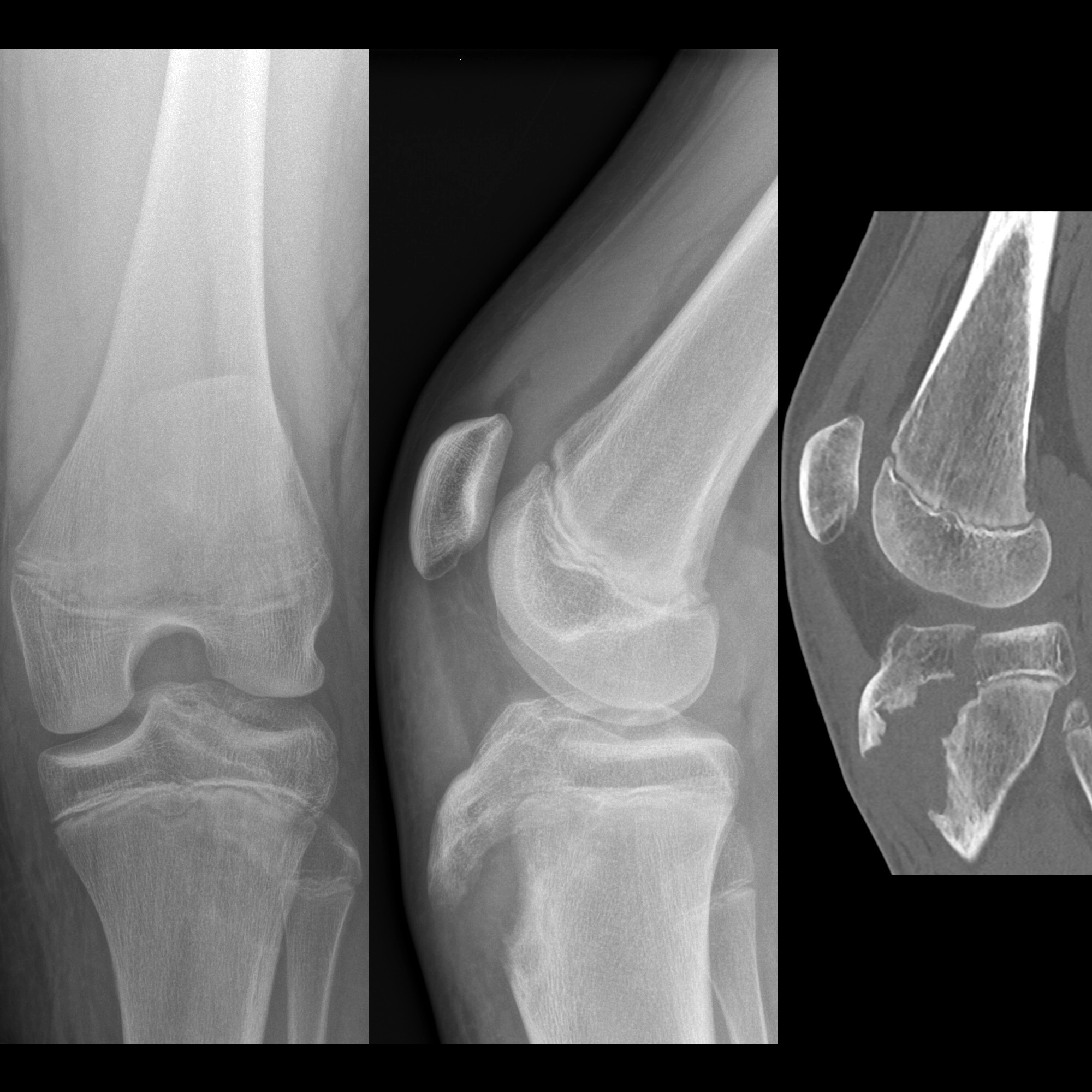 Pediatric Tibial Tuberosity Avulsion Fracture | Pediatric Radiology ...