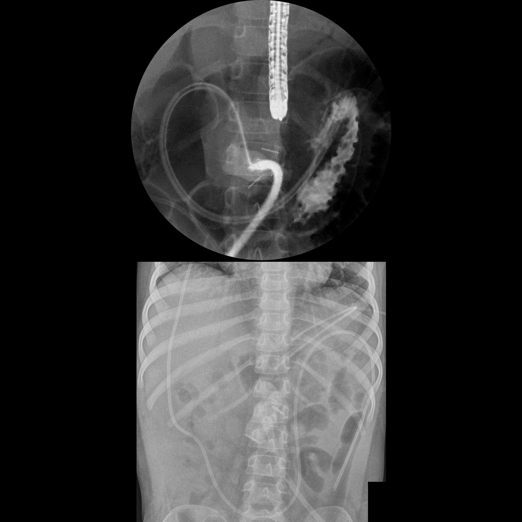 Pediatric Gastrojejunostomy Tube Malfunction / Malposition ...