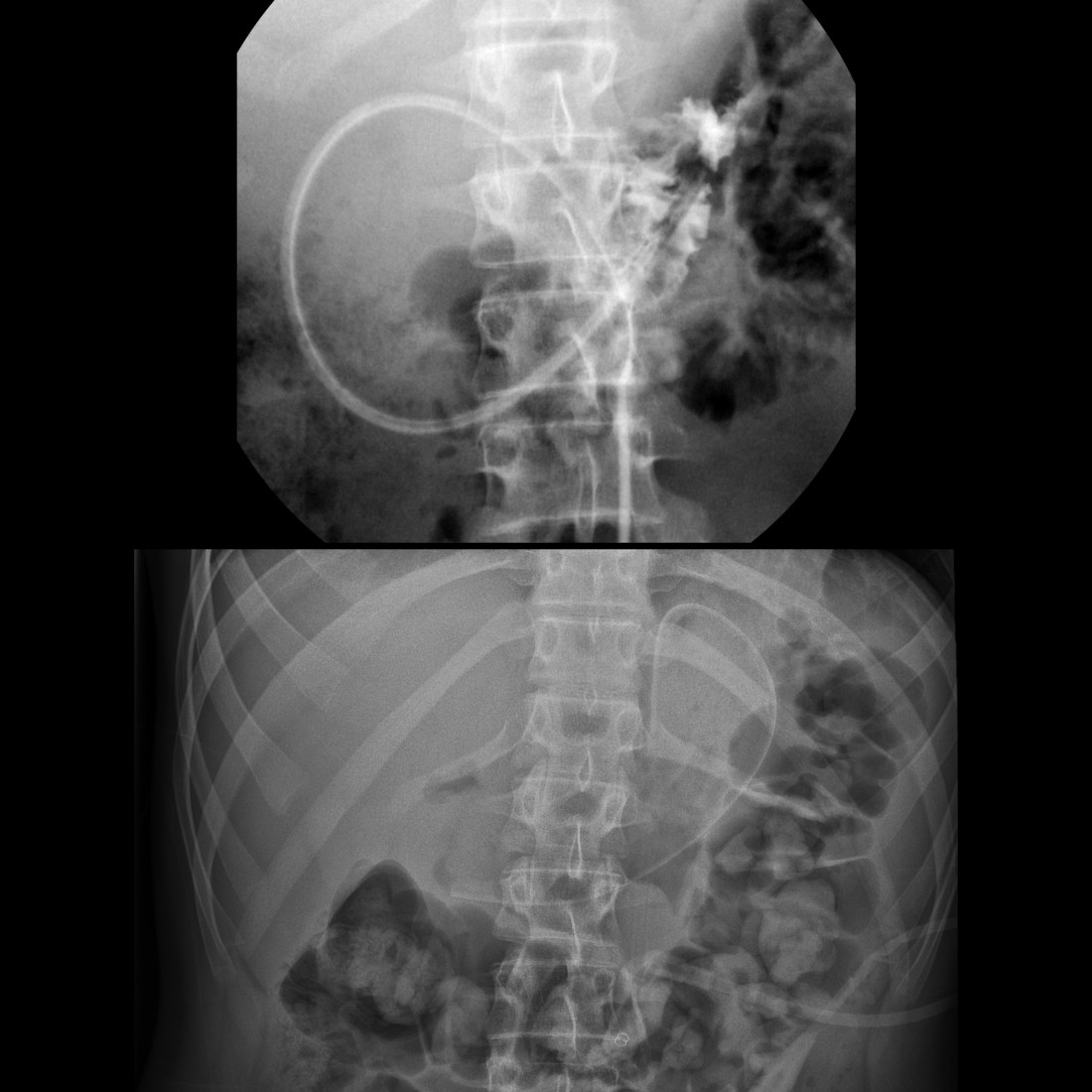 Pediatric Gastrojejunostomy Tube Malfunction / Malposition ...