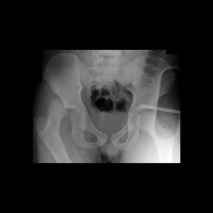 Pediatric Traumatic Hip Dislocation | Pediatric Radiology Reference ...