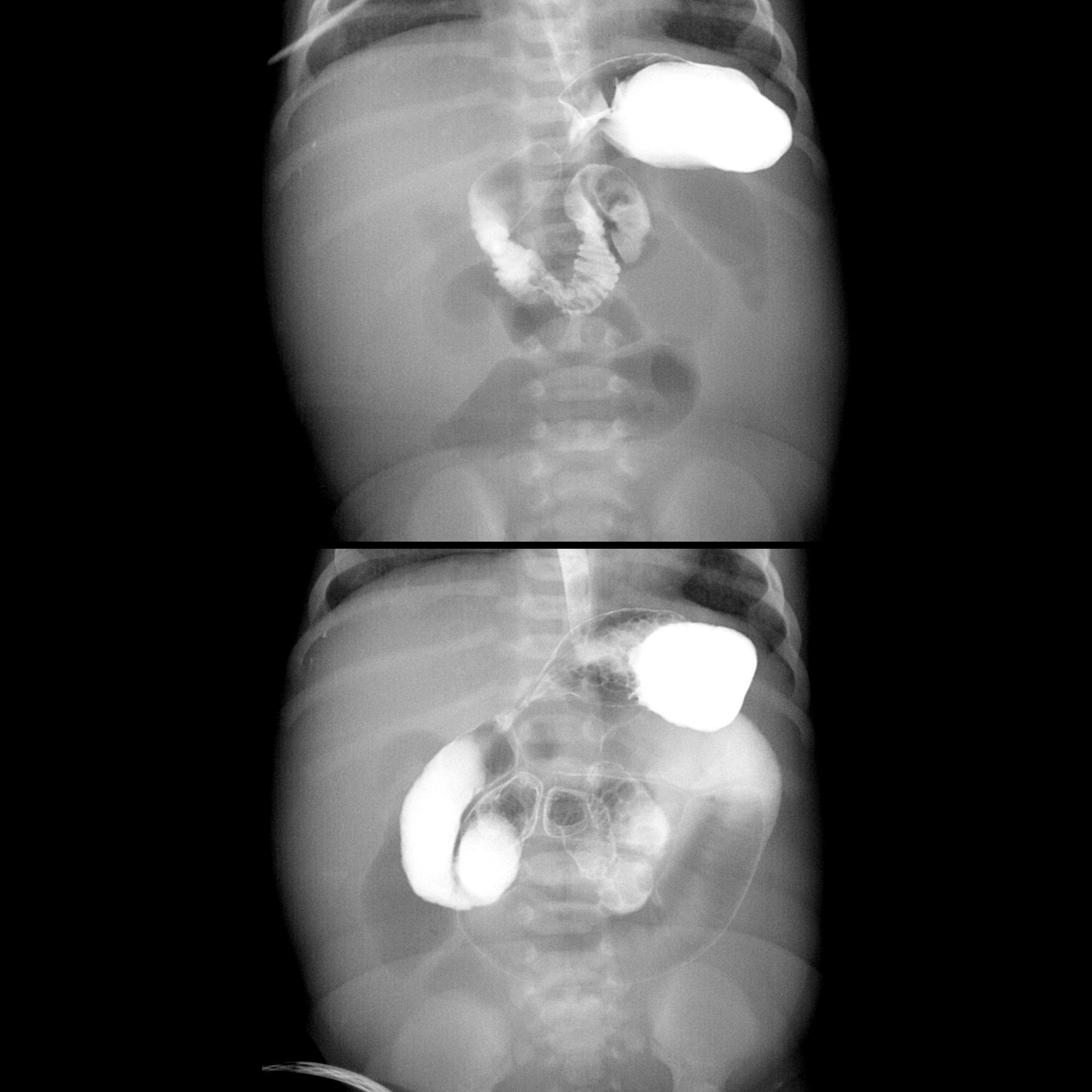 Newborn with bilious vomiting who has passed meconium | Pediatric ...