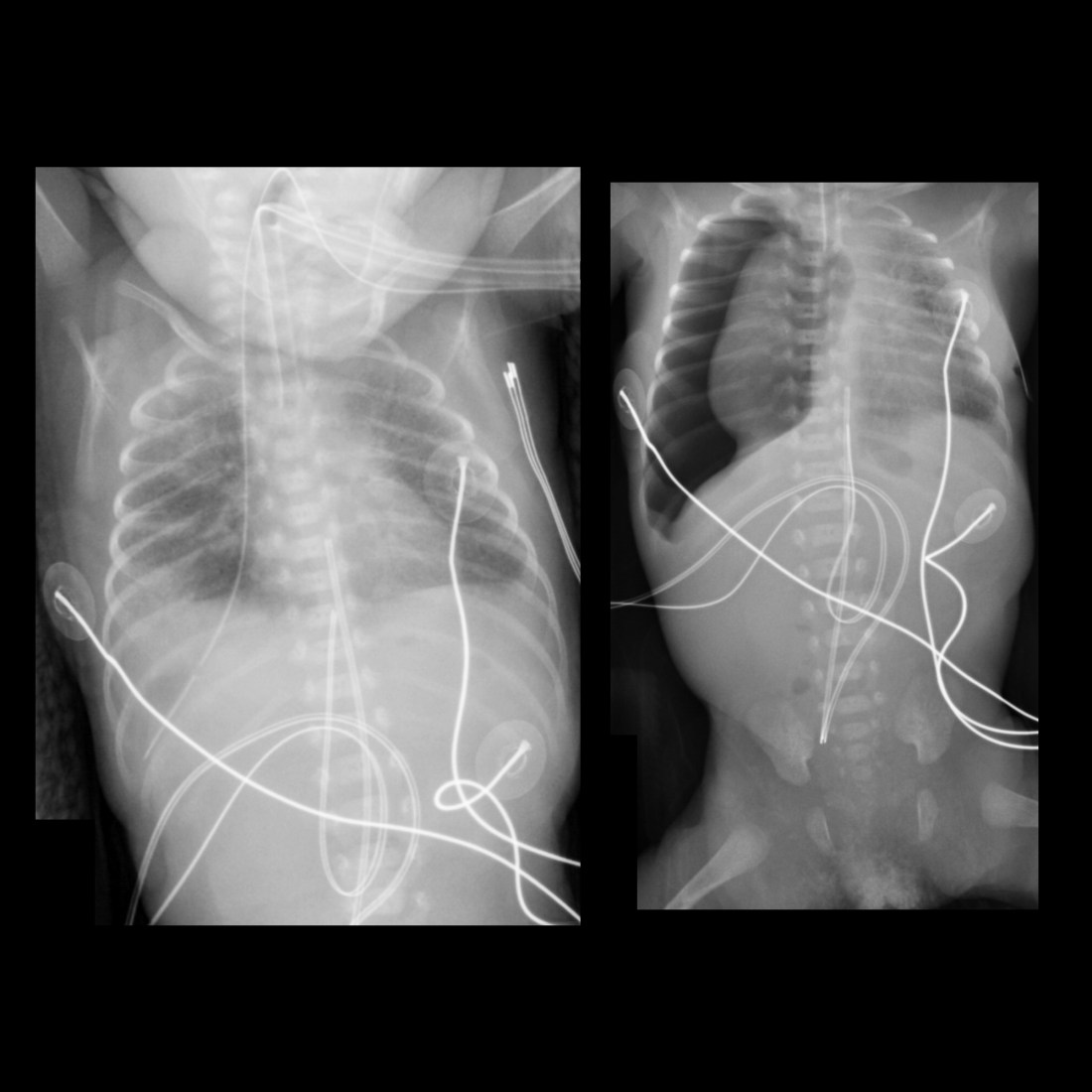 Pediatric Nasogastric Tube Malfunction / Malposition / Misposition ...