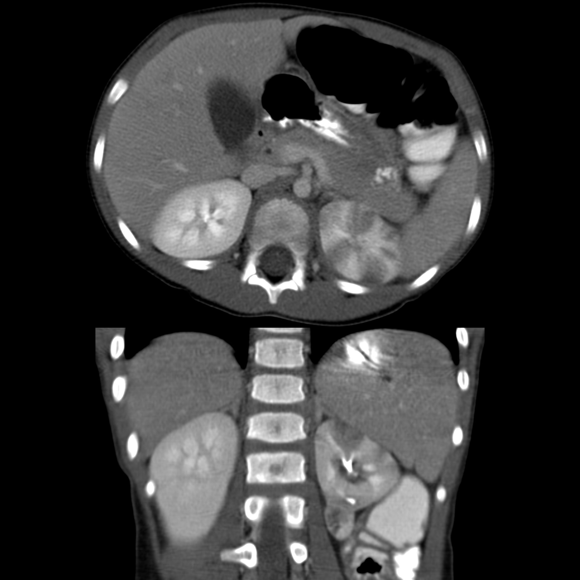 Pediatric Acute Pyelonephritis | Pediatric Radiology Reference Article ...