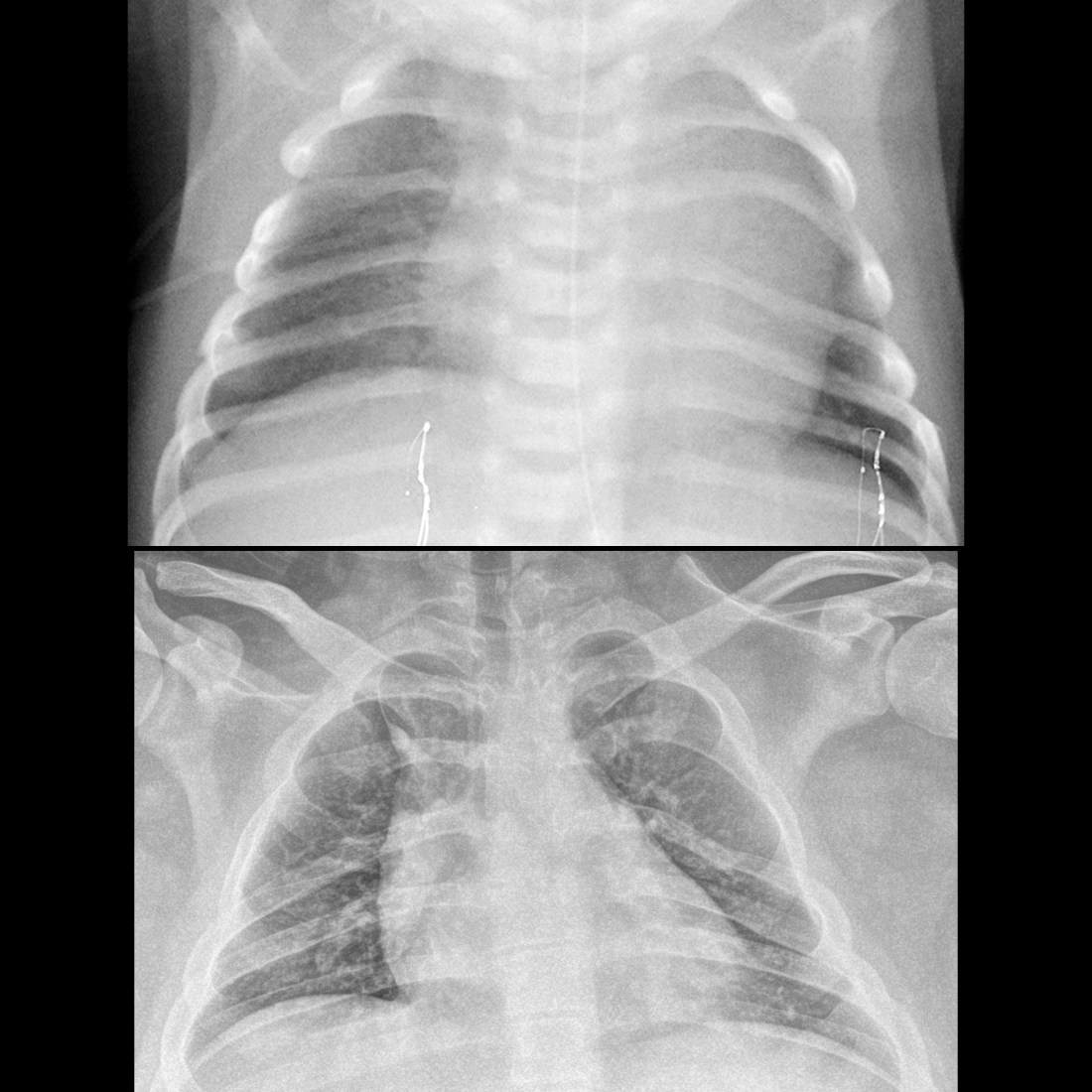 Pediatric Bifid Rib | Pediatric Radiology Reference Article | Pediatric ...