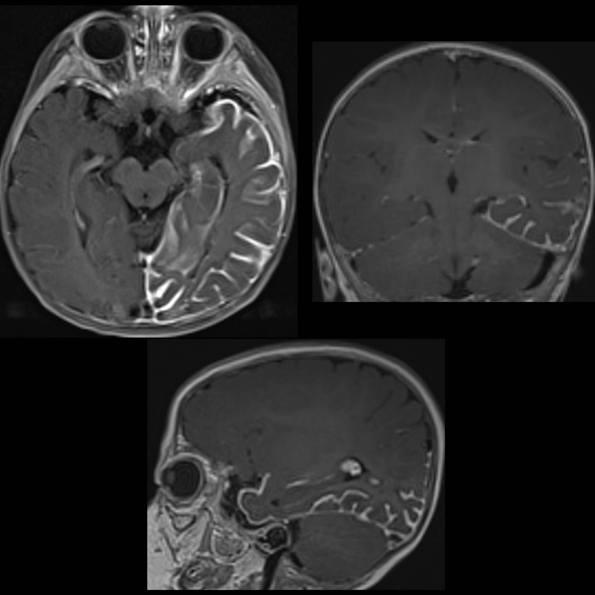 Sturge-Weber Syndrome | Pediatric Radiology Reference Article ...