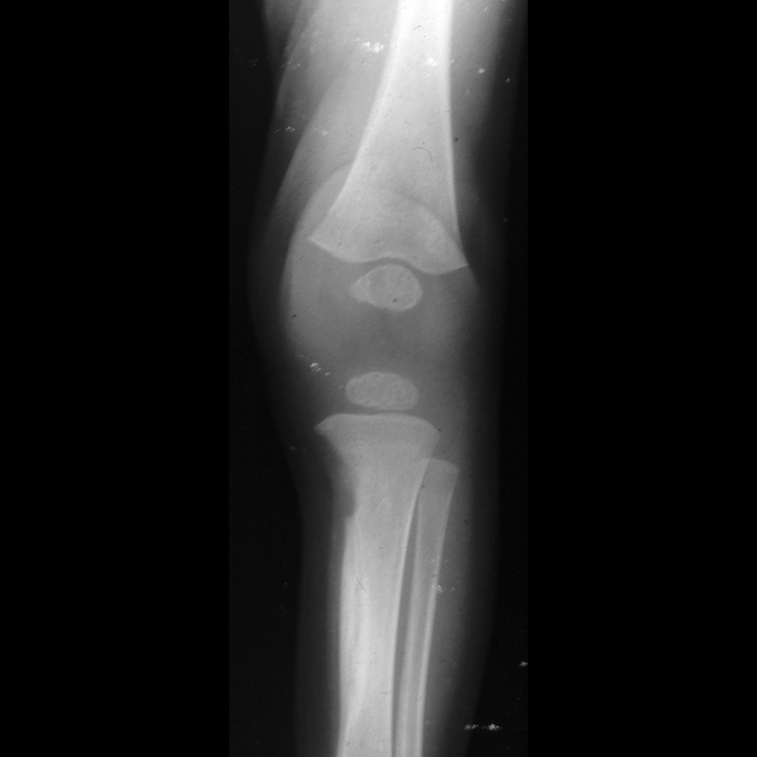 Pediatric Syphilis | Pediatric Radiology Reference Article | Pediatric ...