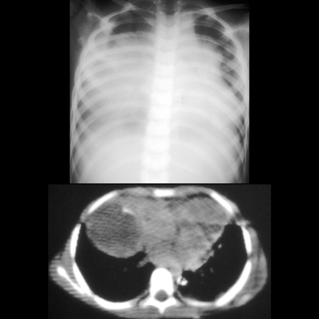 Pediatric Mediastinal Teratoma | Pediatric Radiology Reference Article ...