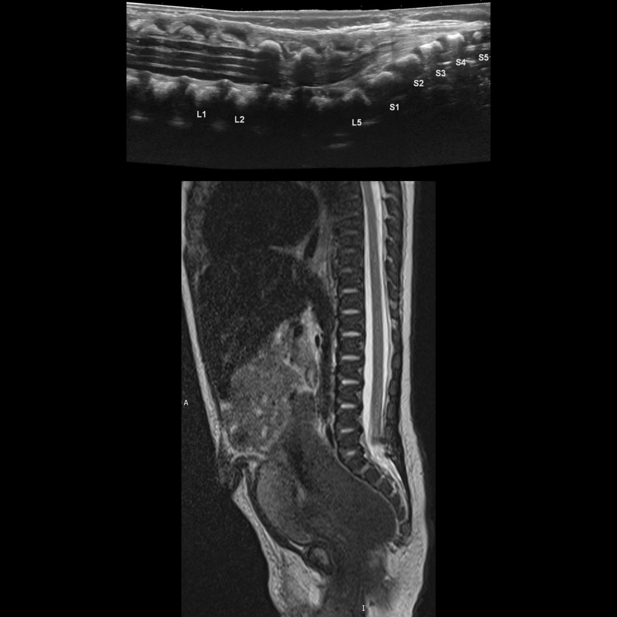 Newborn with a sacral dimple | Pediatric Radiology Case | Pediatric ...