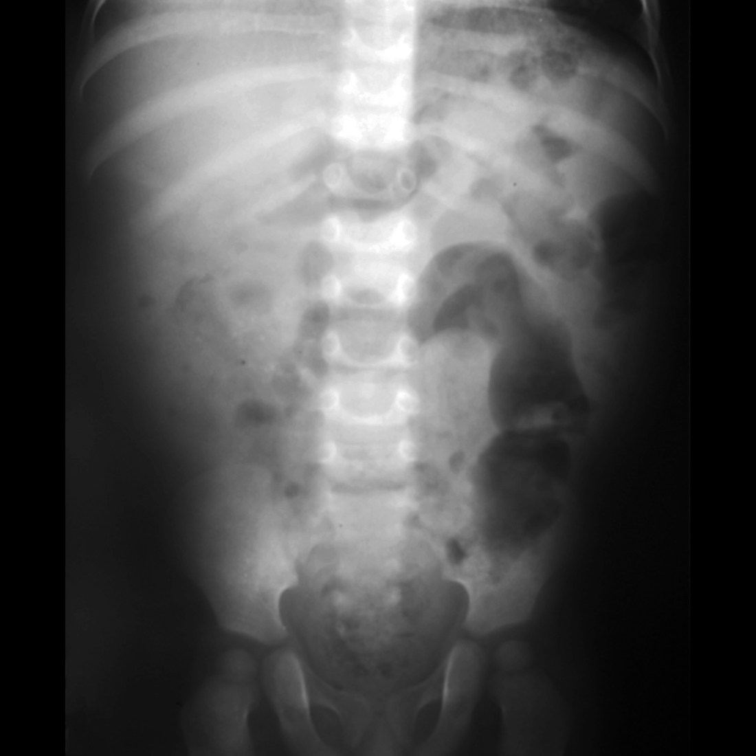 Pediatric Gastrointestinal Tuberculosis | Pediatric Radiology Reference ...