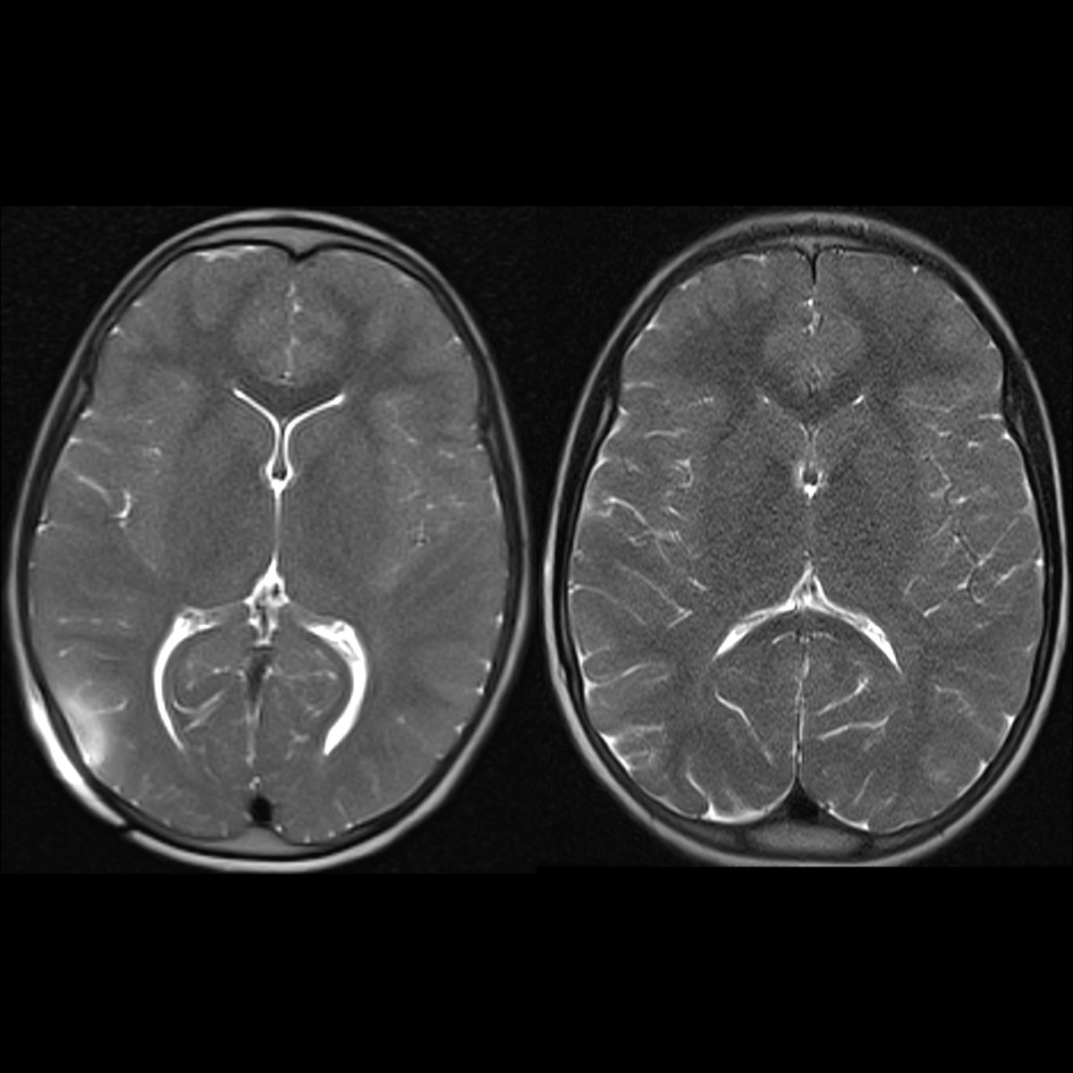 School ager with ventriculoperitoneal shunt and new headache ...
