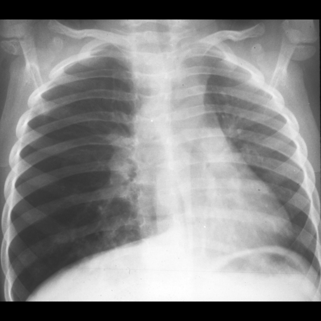 Toddler with wheezing | Pediatric Radiology Case | Pediatric Imaging ...