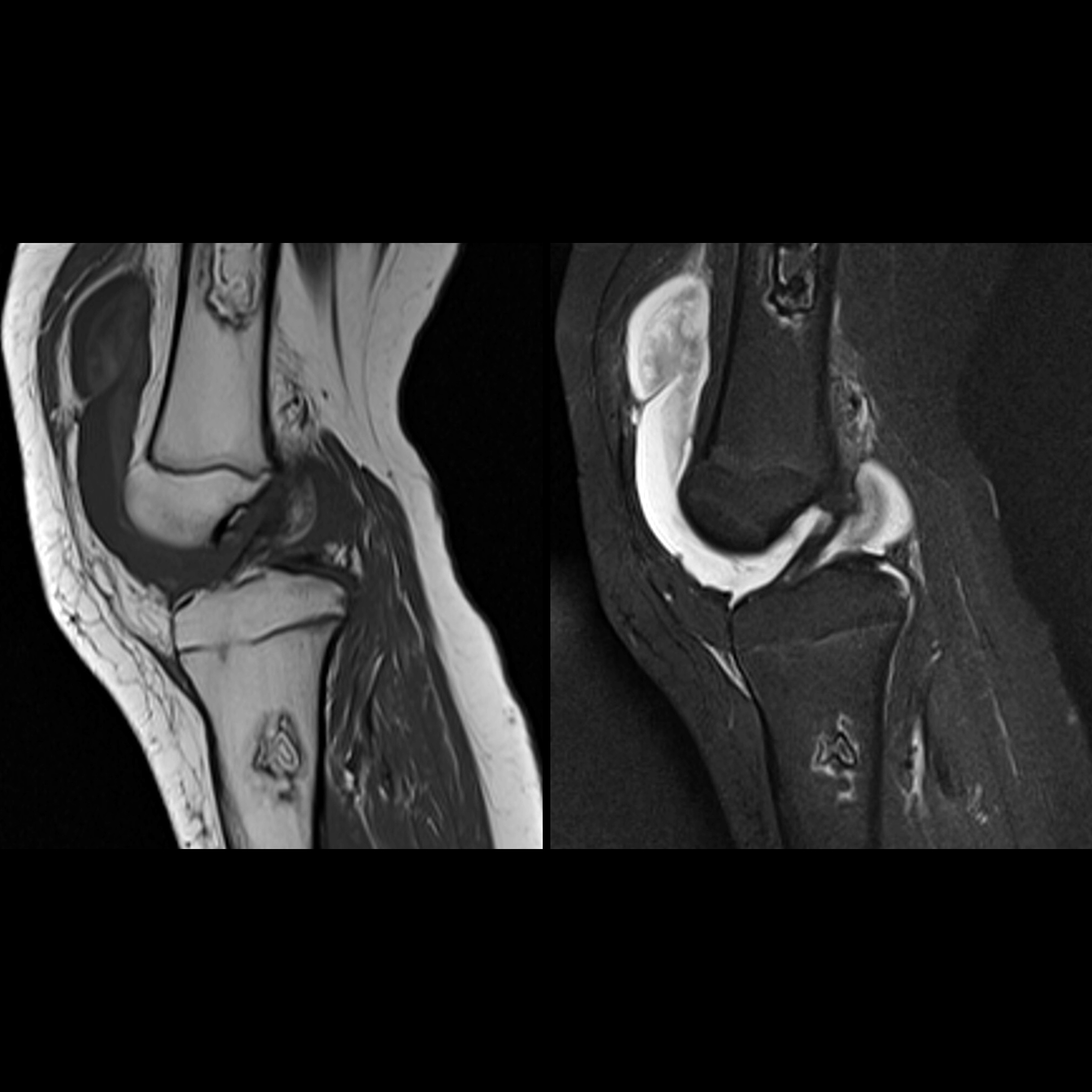 Pediatric Avascular Necrosis of Knee | Pediatric Radiology Reference ...