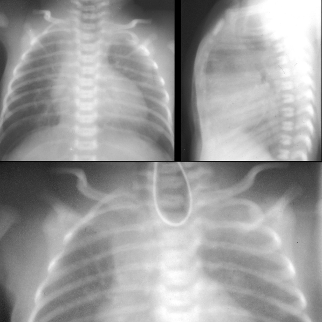 Pediatric Nasogastric Tube Malfunction / Malposition / Misposition ...
