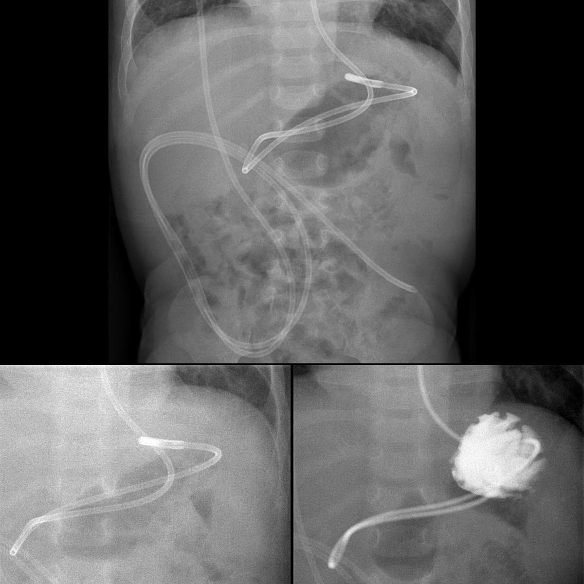 Infant having difficulties with tube feedings | Pediatric Radiology ...