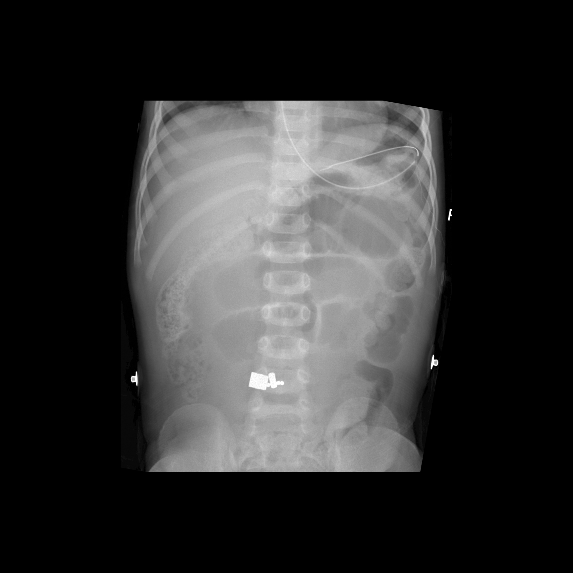 ForeignBodyGastrointestinal08MDRareEarthMagnetsNineSmallBowelObstructio ...