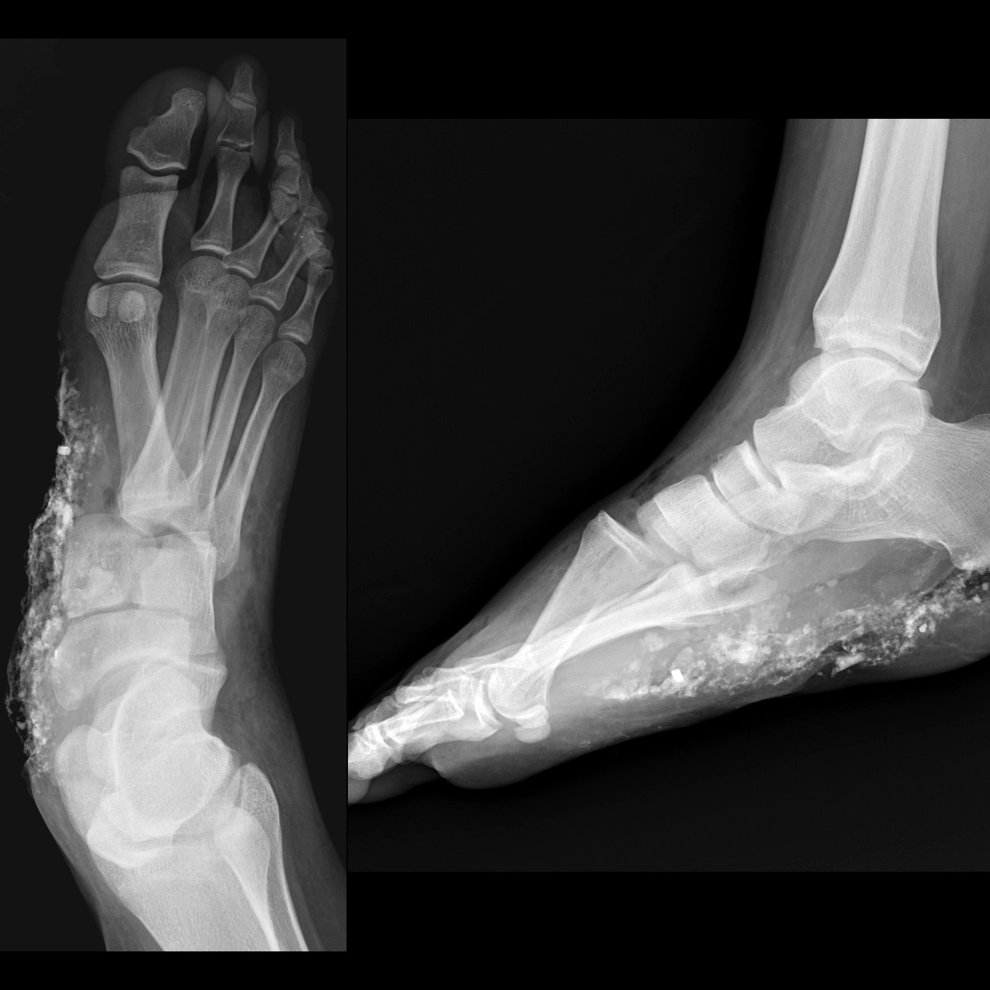 Pediatric Lisfranc Fracture Dislocation | Pediatric Radiology Reference ...