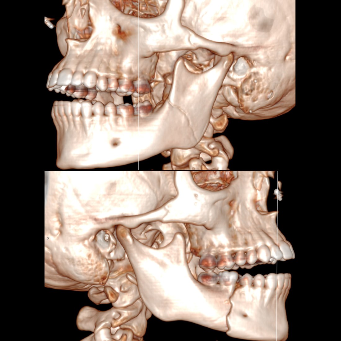Pediatric Mandibular Fracture | Pediatric Radiology Reference Article ...