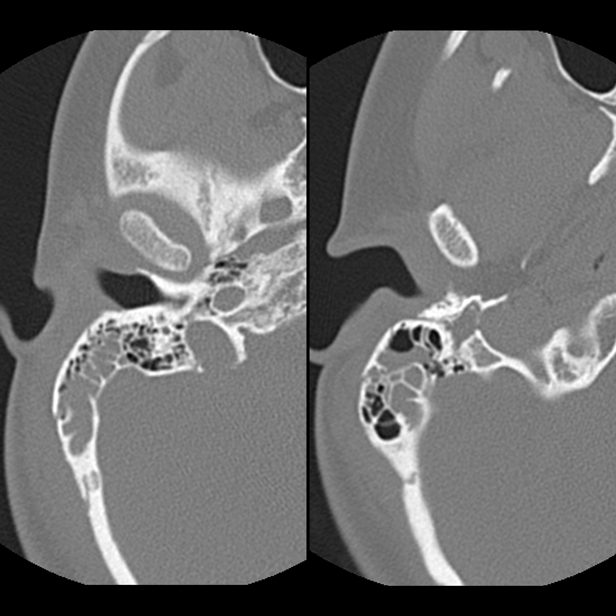 Pediatric Mastoid Fracture | Pediatric Radiology Reference Article ...