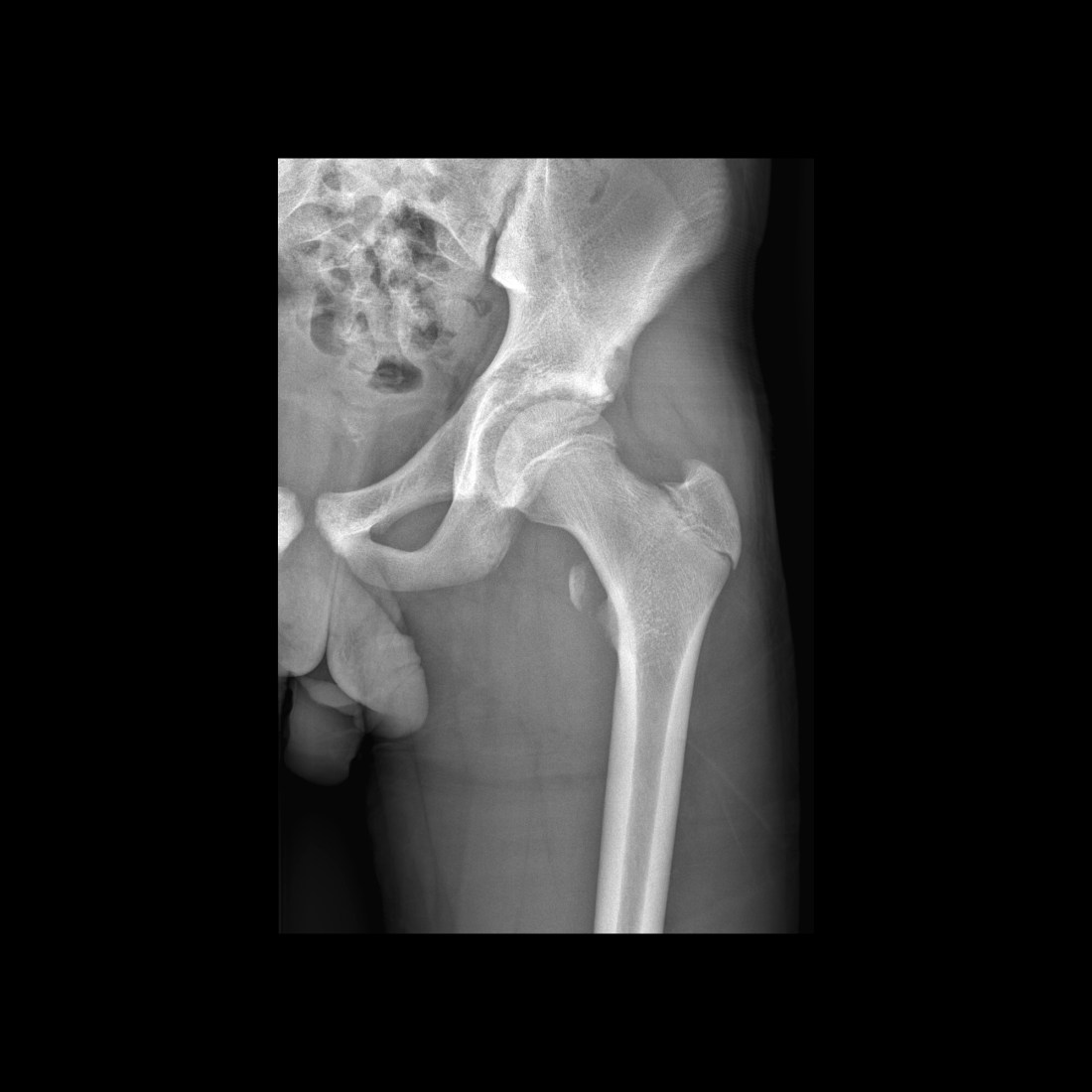 Avulsion Fracture Hip Avulsion Fractures | Children Sports Injury | We