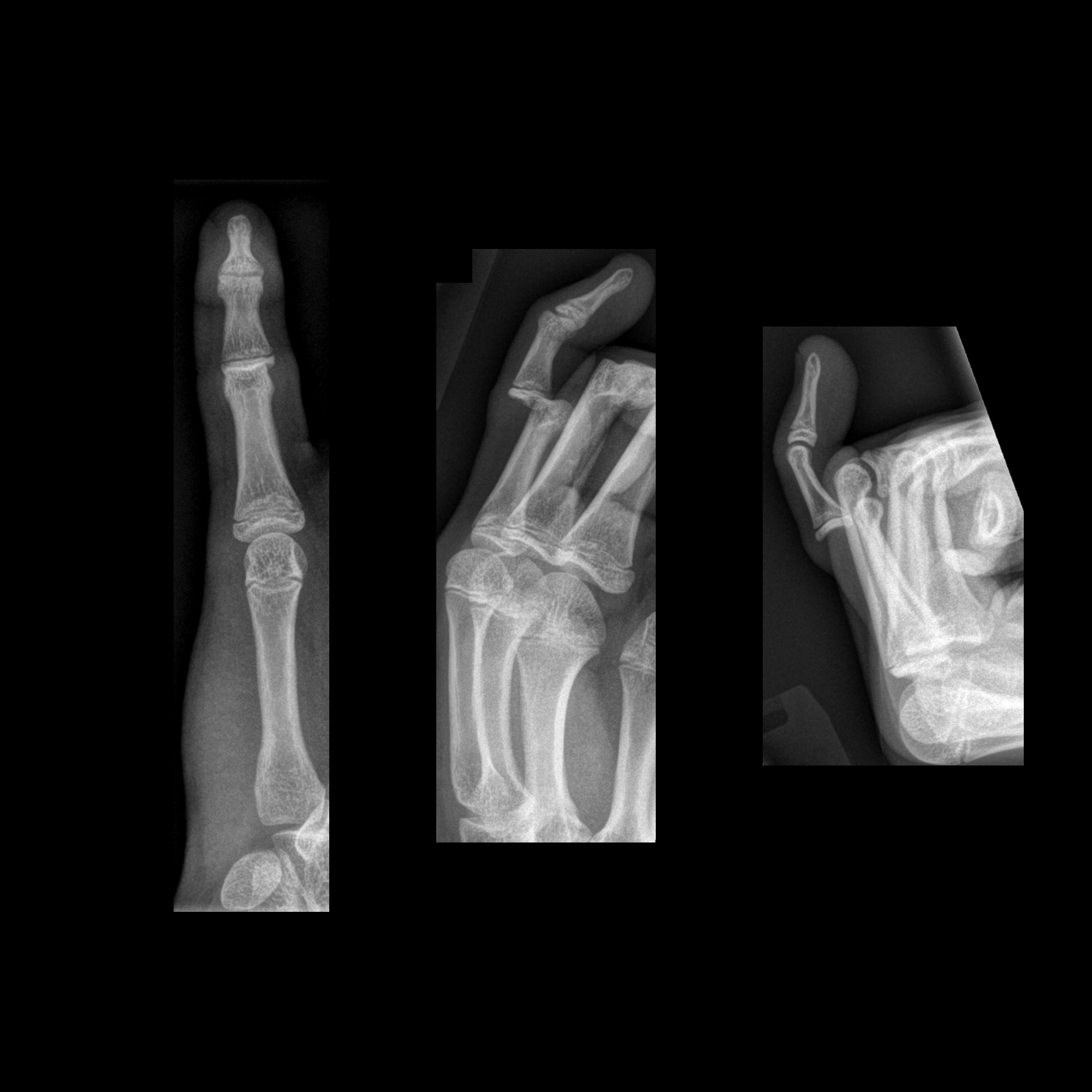 Pediatric Phalanx Fracture in the Hand | Pediatric Radiology Reference ...