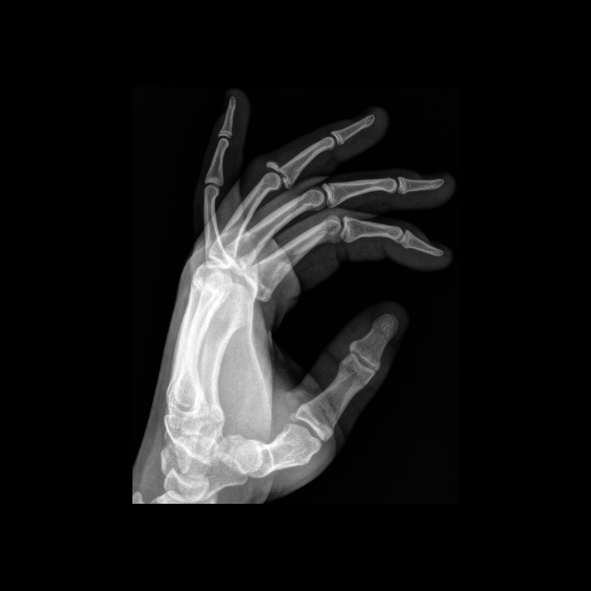 FractureSalterHarrisIII01MDJammedFingerFourthMiddlePhalanxPln15yo ...