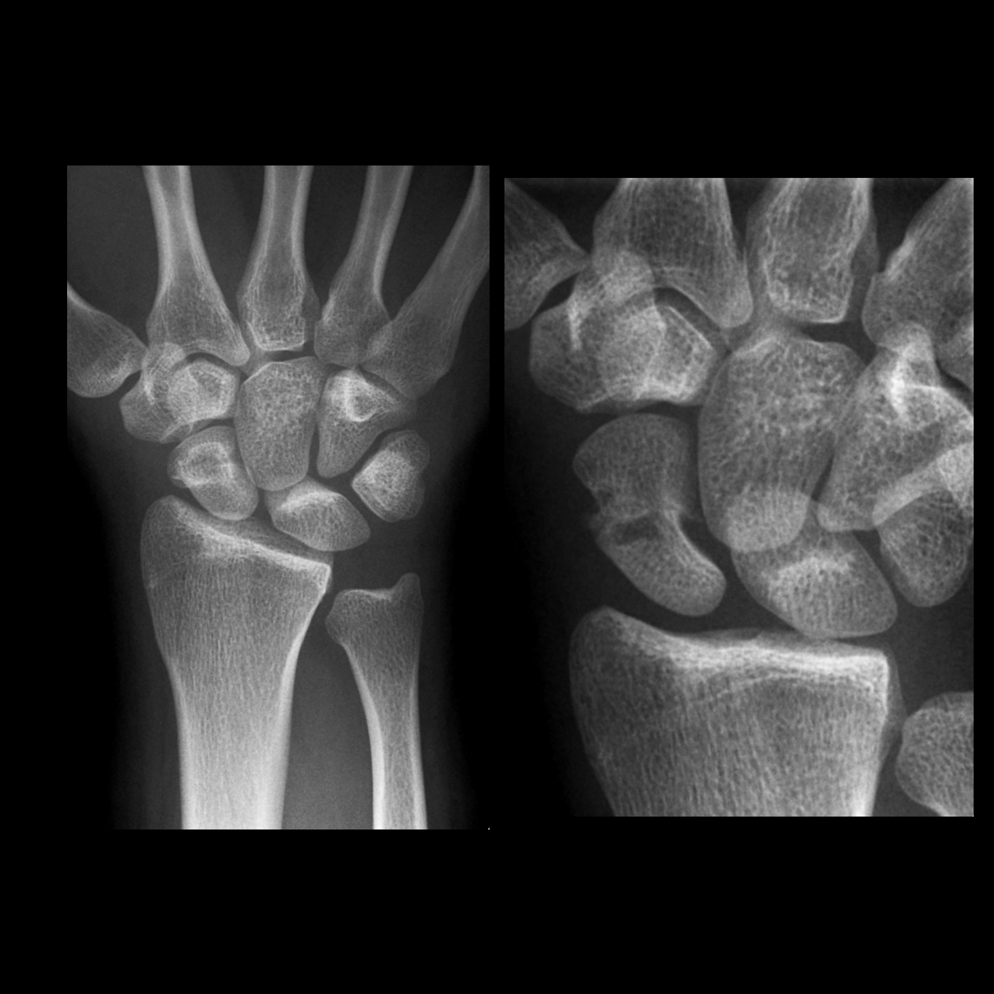 Pediatric Scaphoid Fracture | Pediatric Radiology Reference Article ...