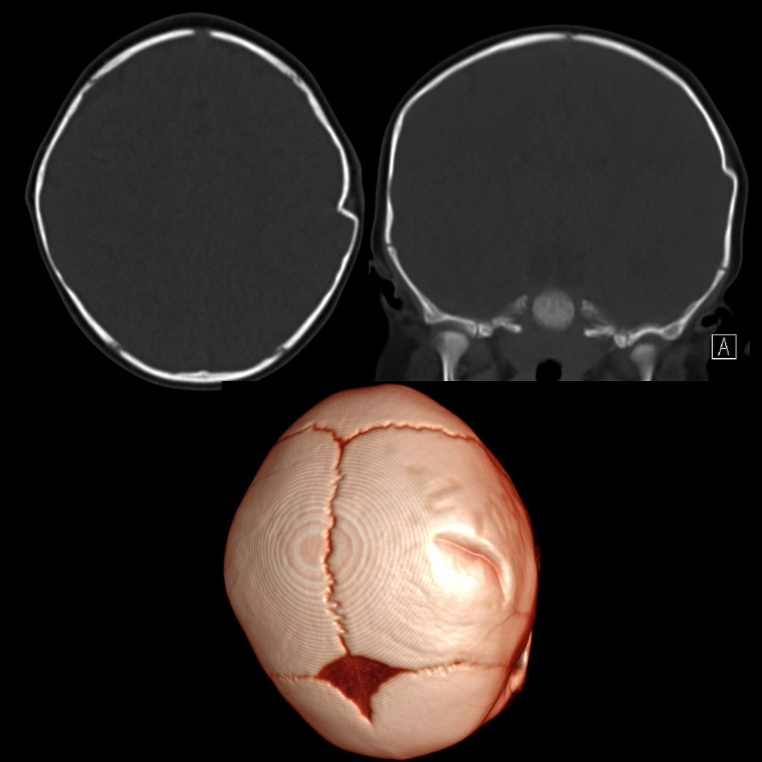 Pediatric Skull Fracture | Pediatric Radiology Reference Article ...