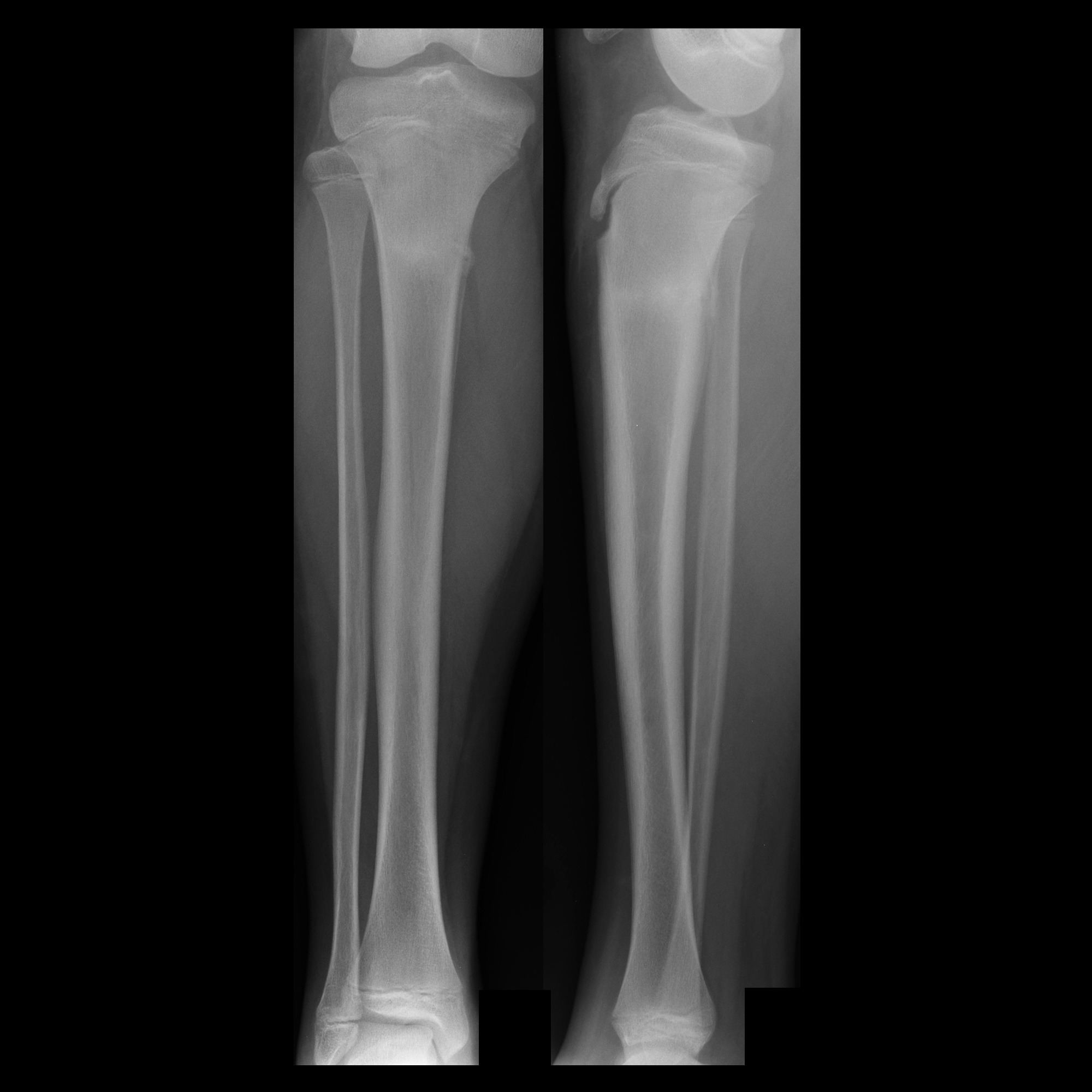 Pediatric Stress Fracture | Pediatric Radiology Reference Article ...