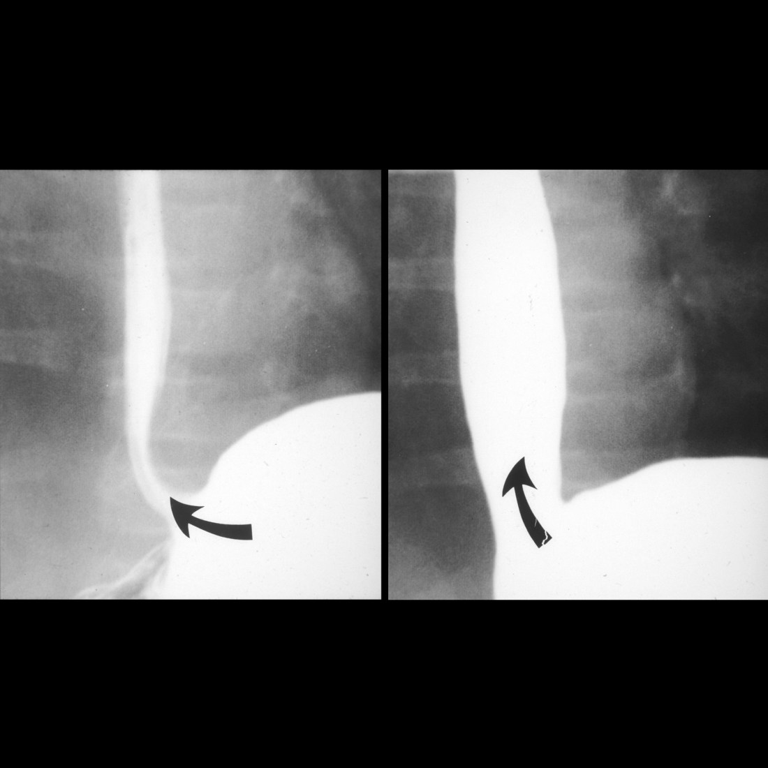 Pediatric Gastroesophageal Reflux | Pediatric Radiology Reference ...