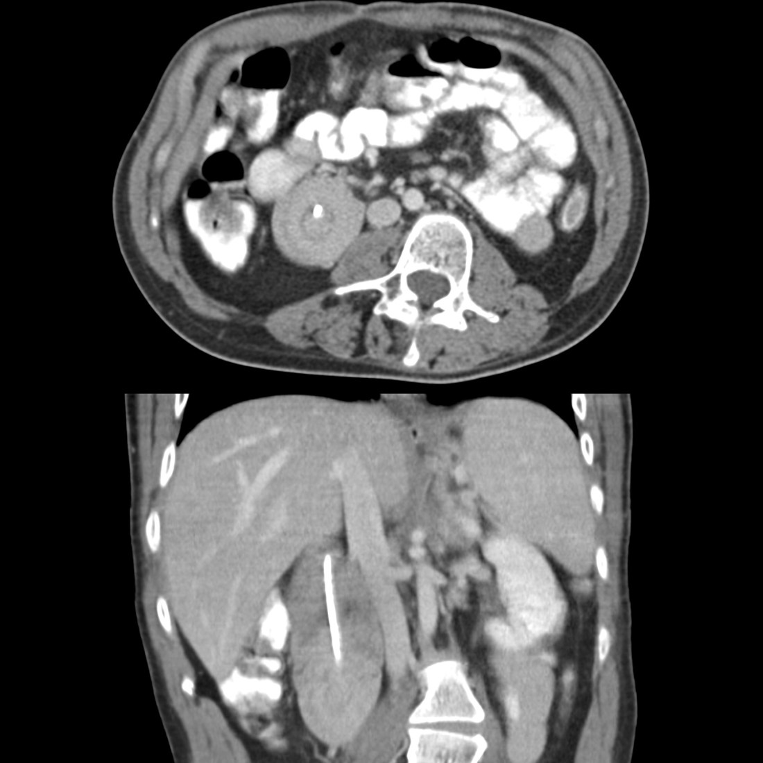 Pediatric Small Bowel-Small Bowel Intussusception | Pediatric Radiology ...