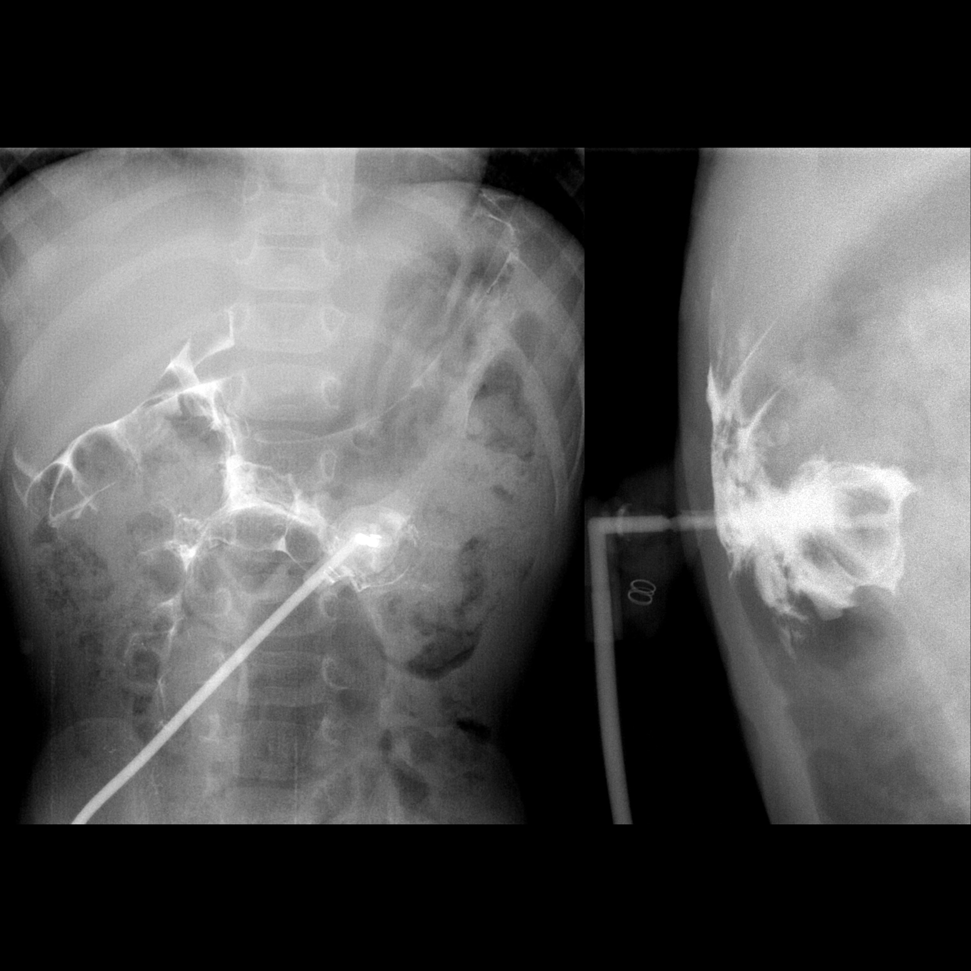 Pediatric Gastrostomy Tube Malfunction / Malposition / Misposition ...