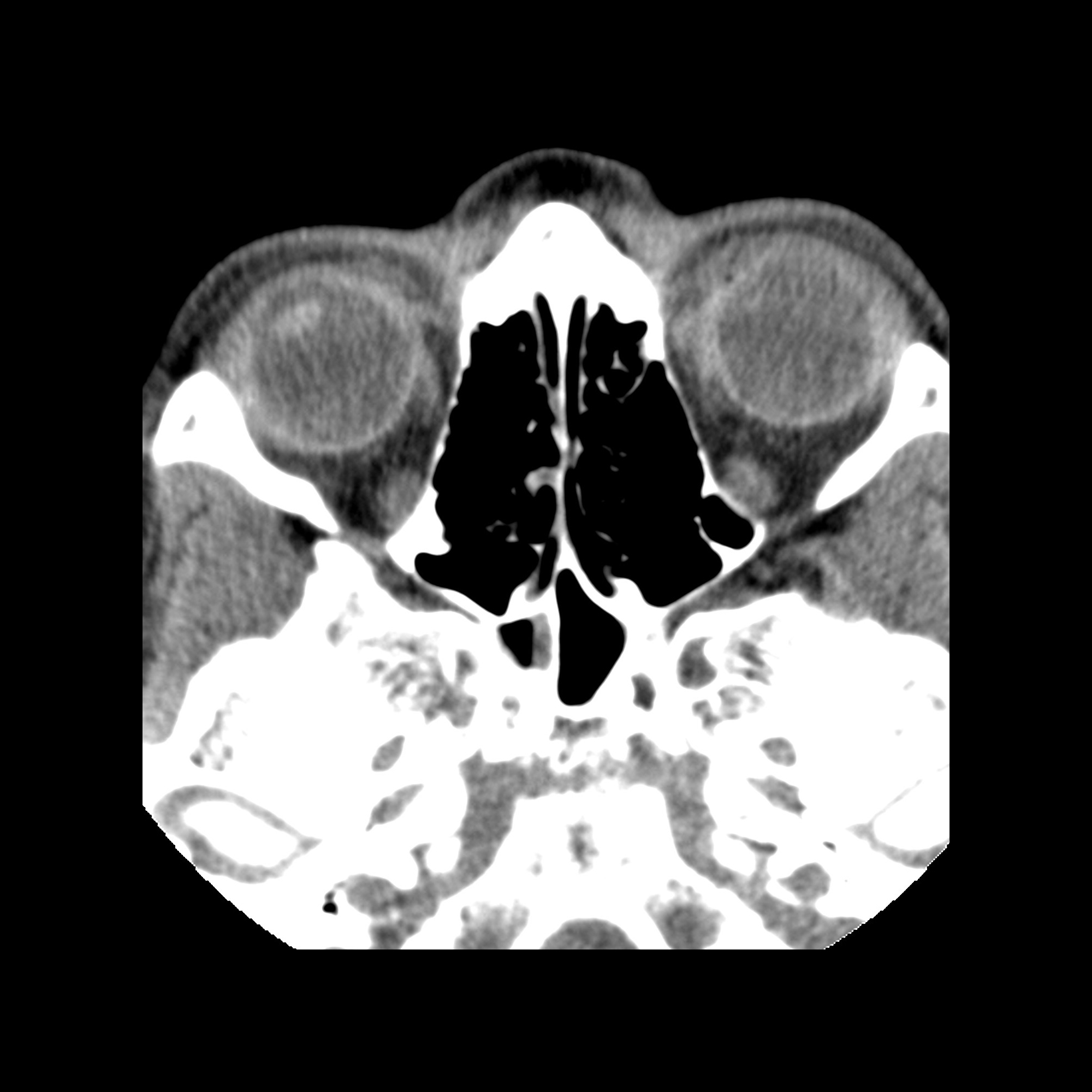 Pediatric Globe Rupture | Pediatric Radiology Reference Article ...