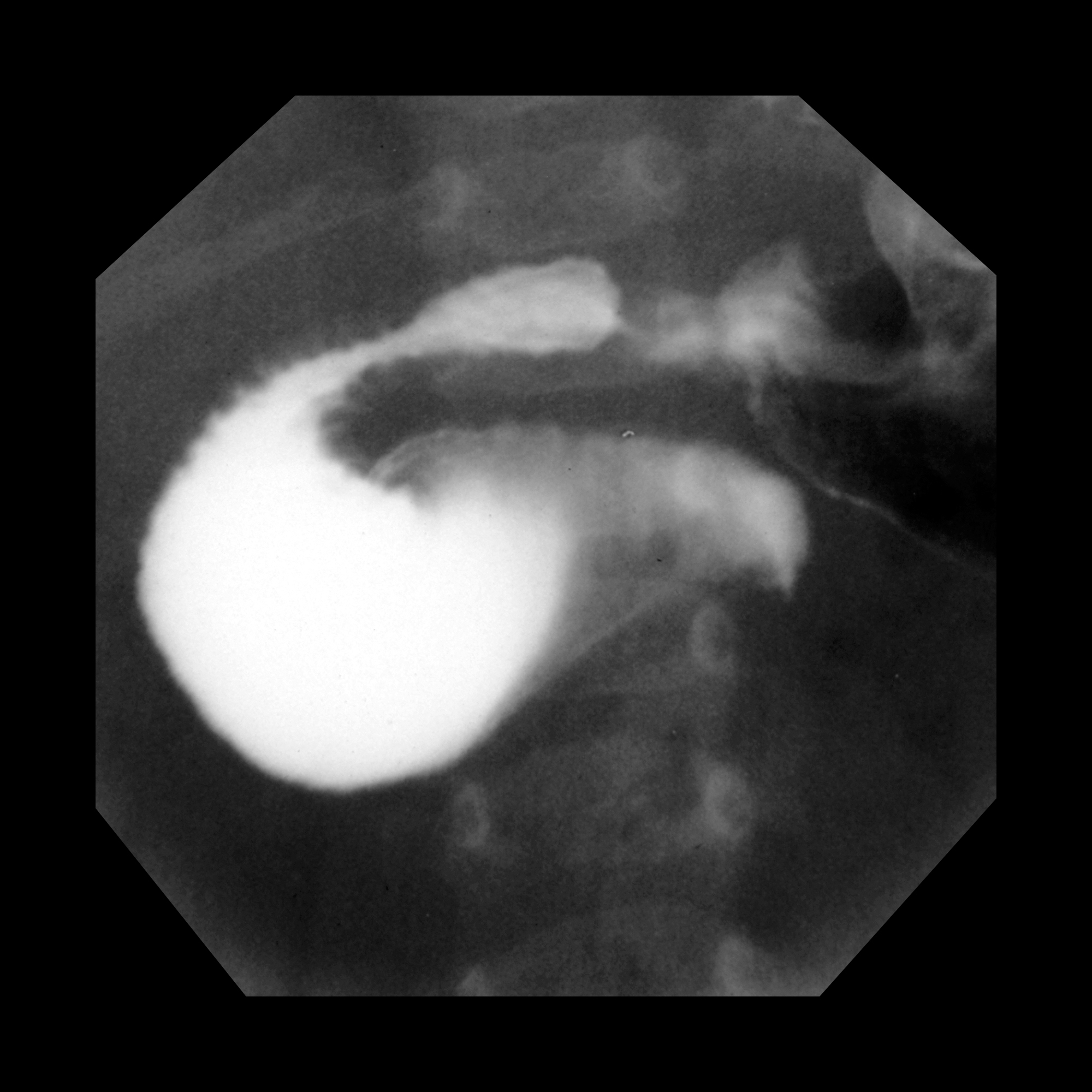 Infant with bilious vomiting | Pediatric Radiology Case | Pediatric ...