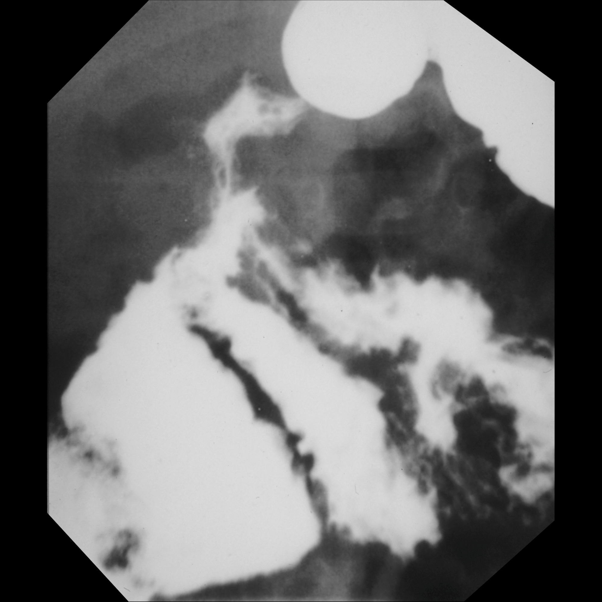 Infant with bilious vomiting | Pediatric Radiology Case | Pediatric ...