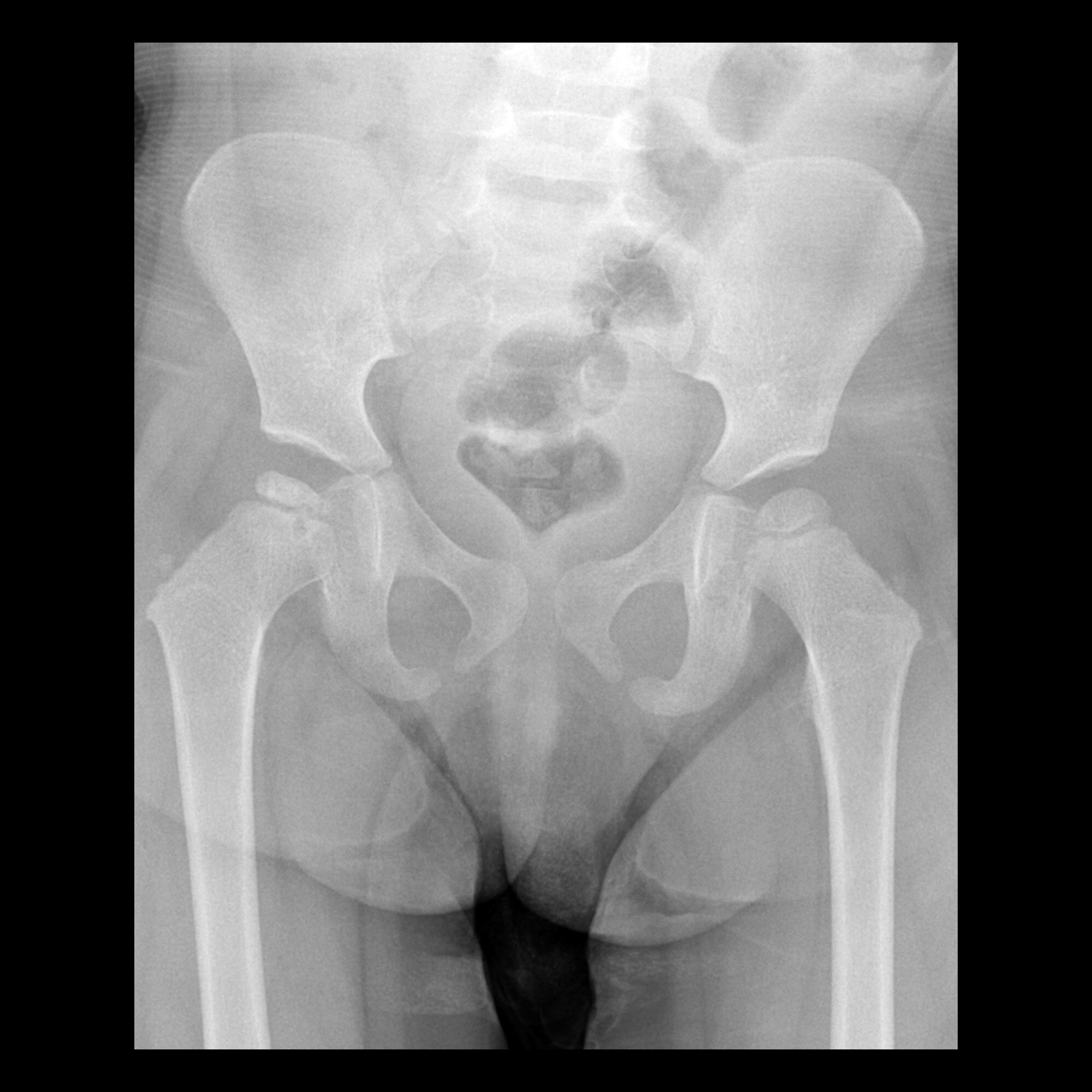 Meyer Dysplasia | Pediatric Radiology Reference Article | Pediatric ...