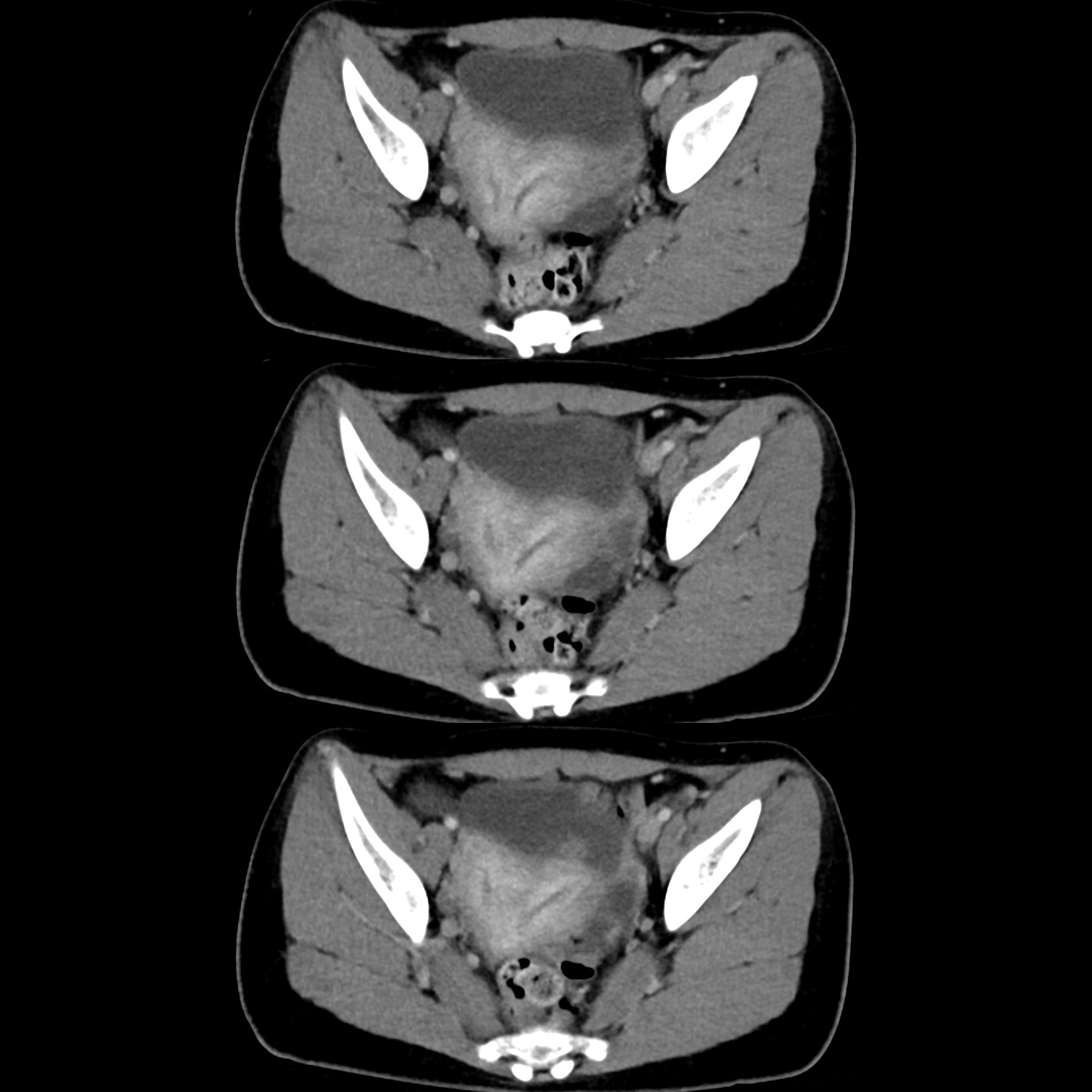 Pediatric Mullerian Duct Anomalies | Pediatric Radiology Reference ...