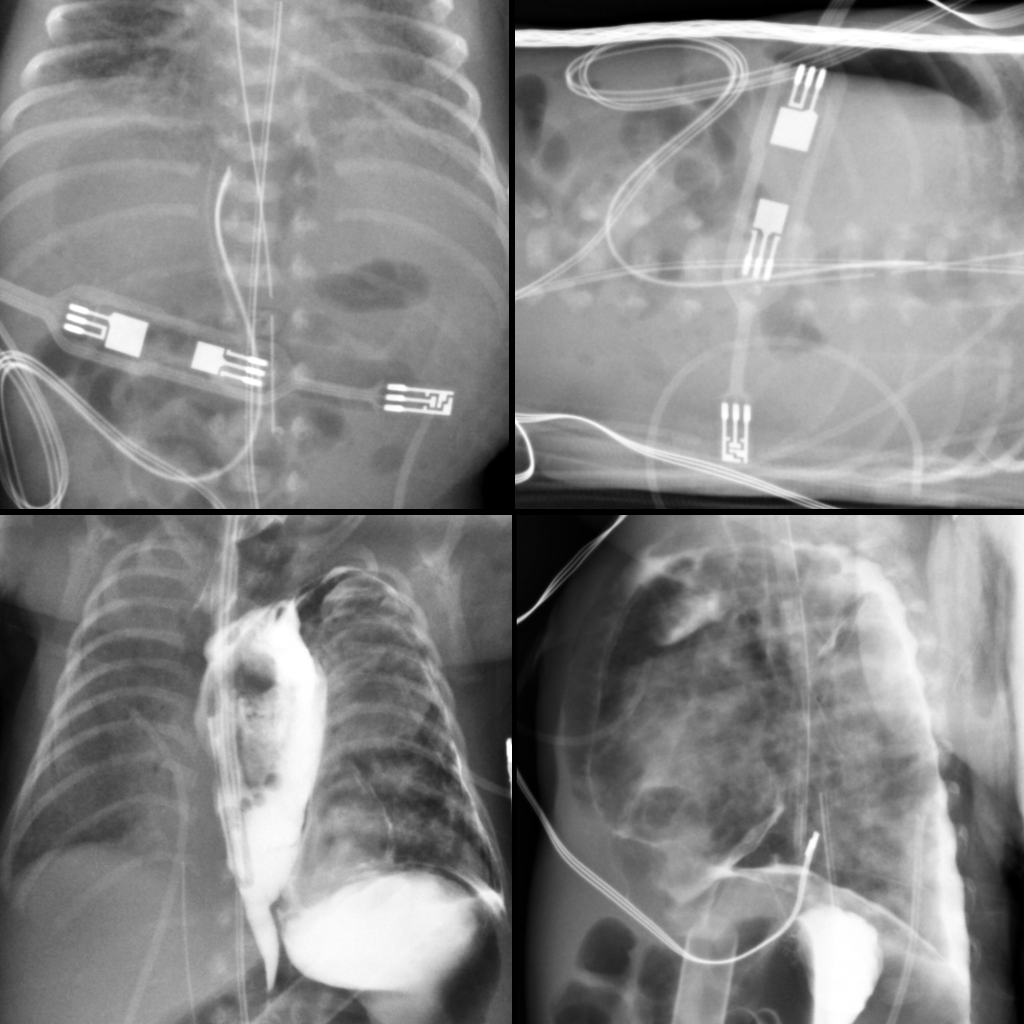 Pediatric Nasogastric Tube Malfunction / Malposition / Misposition ...