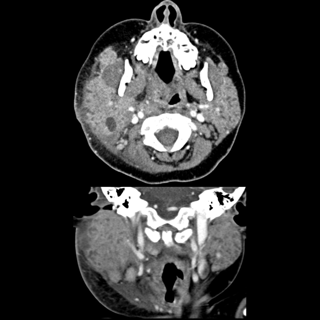 Pediatric Parotitis | Pediatric Radiology Reference Article | Pediatric ...