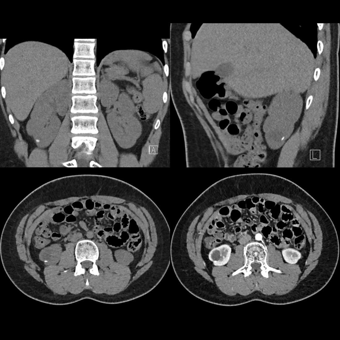 Pediatric Renal Milk of Calcium Cyst | Pediatric Radiology Reference ...
