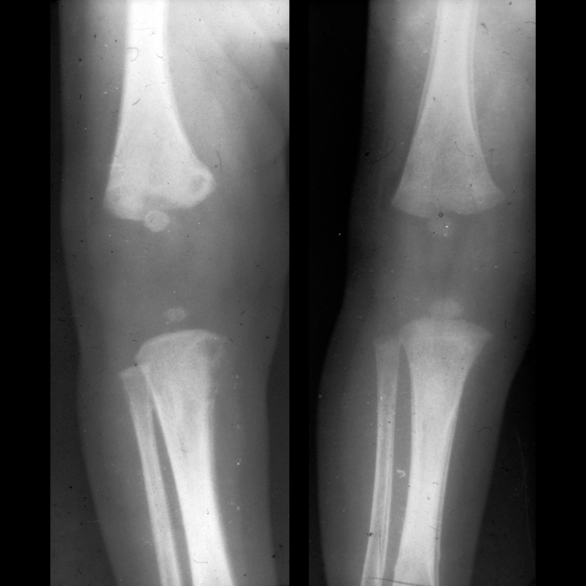 Pediatric Syphilis | Pediatric Radiology Reference Article | Pediatric ...
