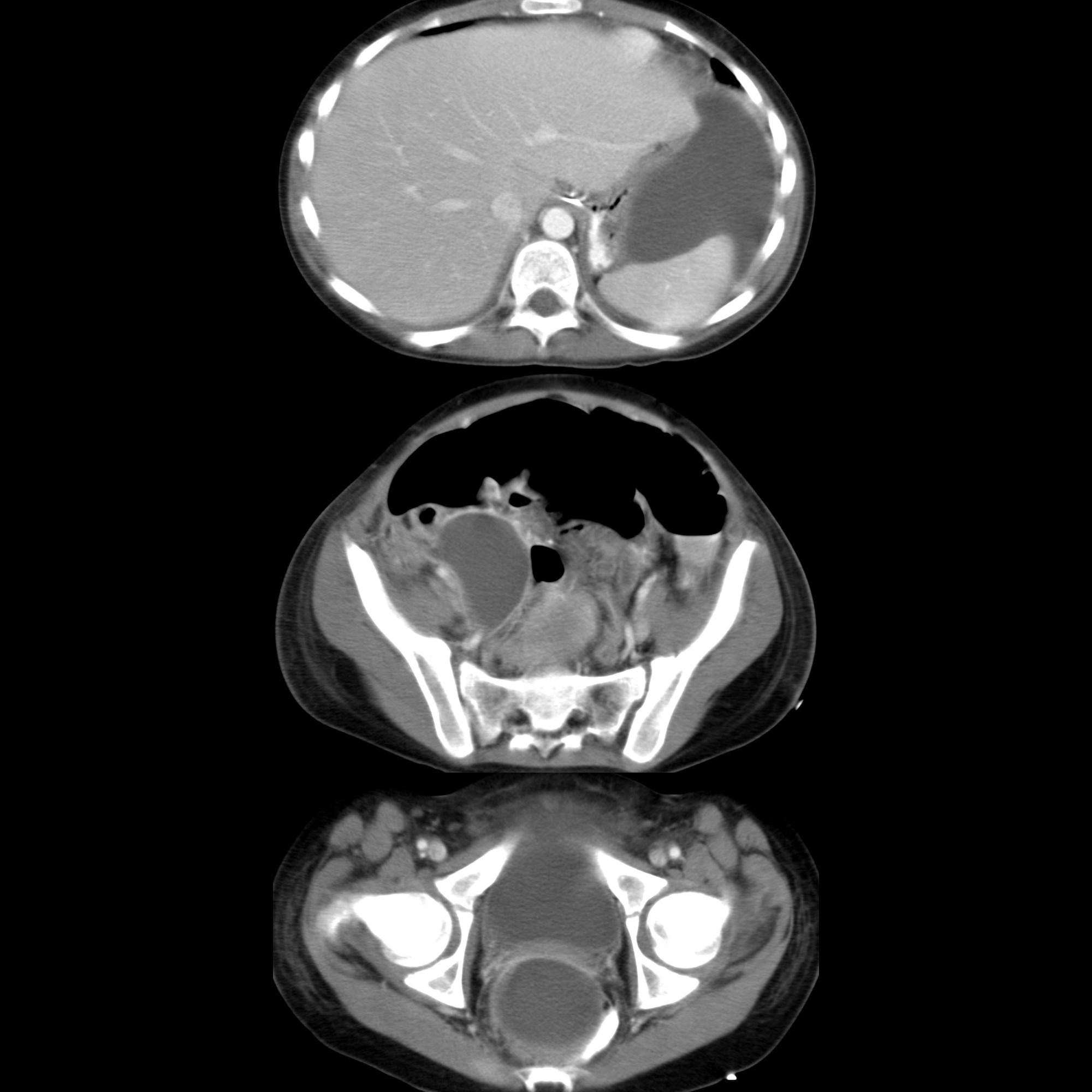 Pediatric Appendicitis | Pediatric Radiology Reference Article ...