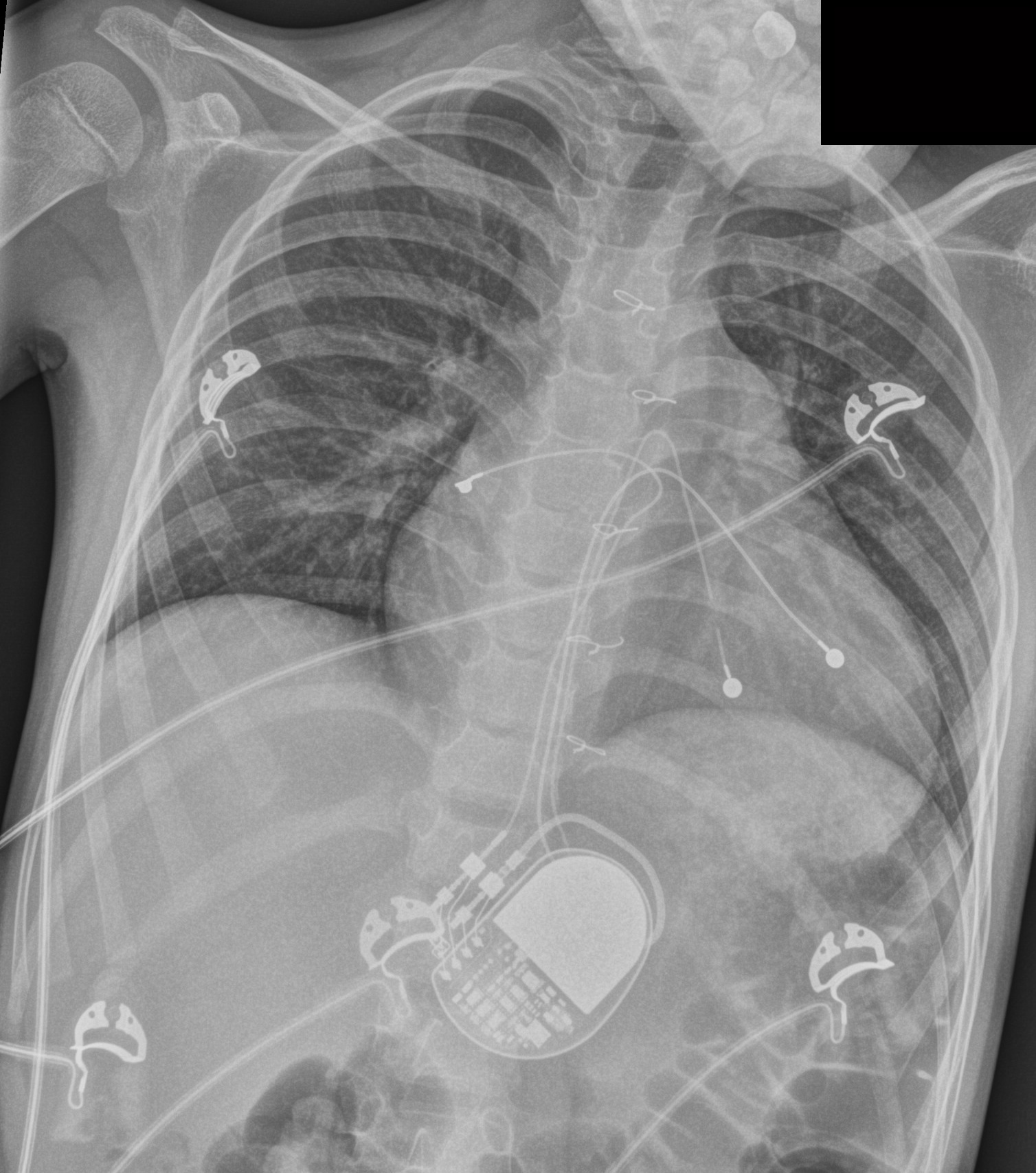 Pediatric Cardiac Pacemaker Lead Malfunction | Pediatric Radiology ...