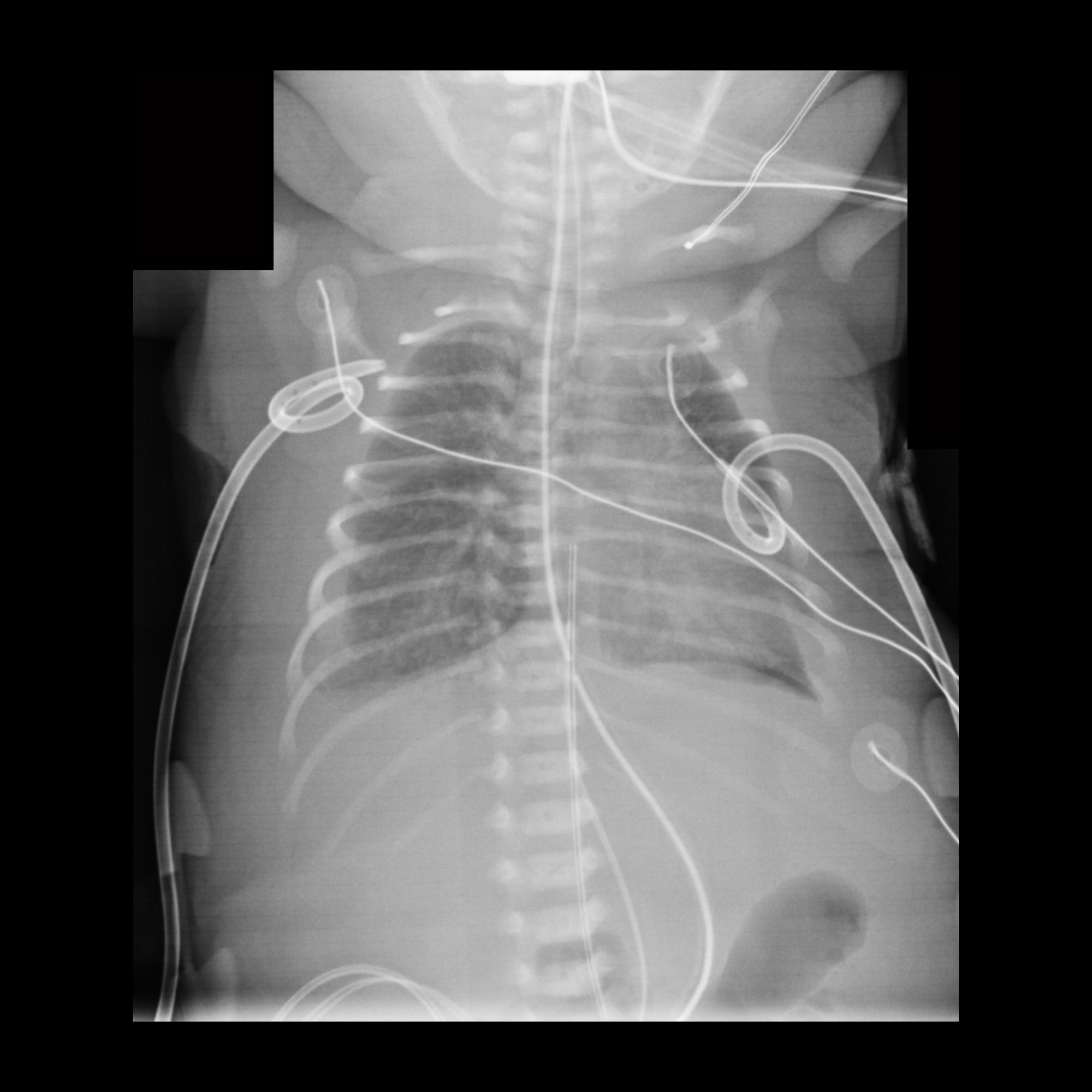 Hydrops Fetalis | Pediatric Radiology Reference Article | Pediatric ...