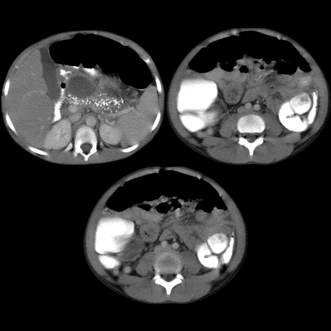 Pediatric Appendicitis | Pediatric Radiology Reference Article ...